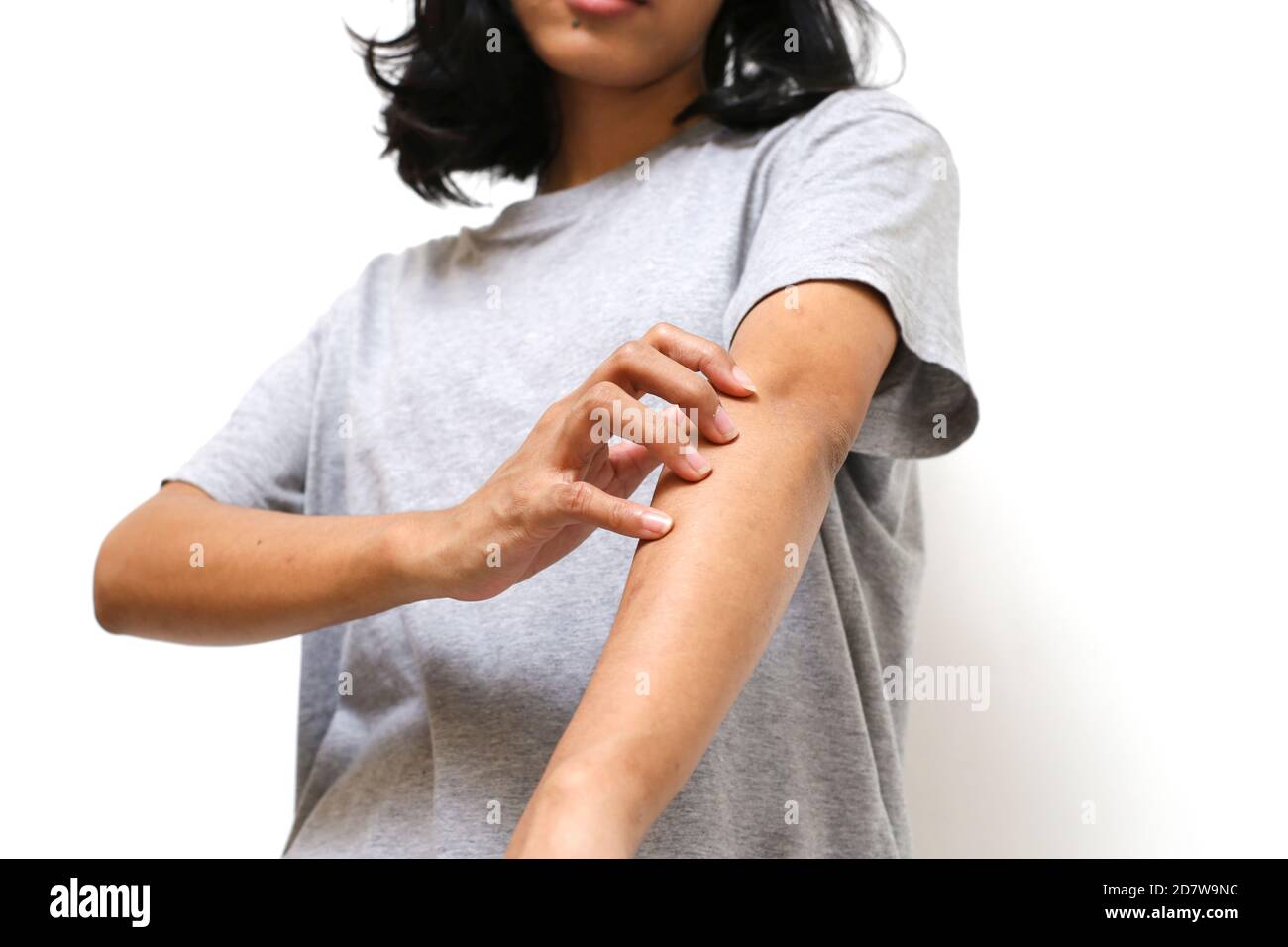 Allergy. Itchy skin. Women's hands are scratched, on white background ...