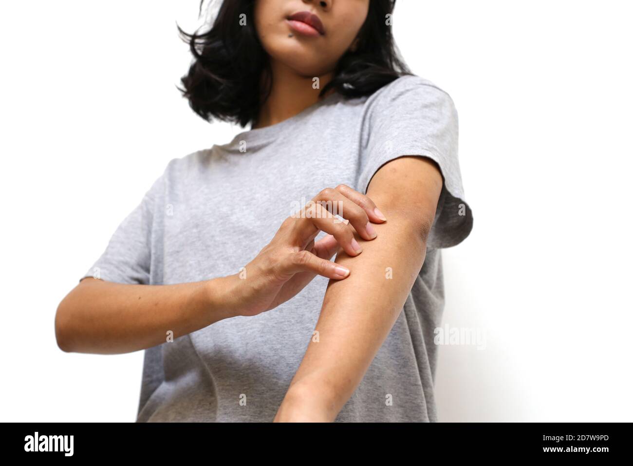 Allergy. Itchy skin. Women's hands are scratched, on white background ...