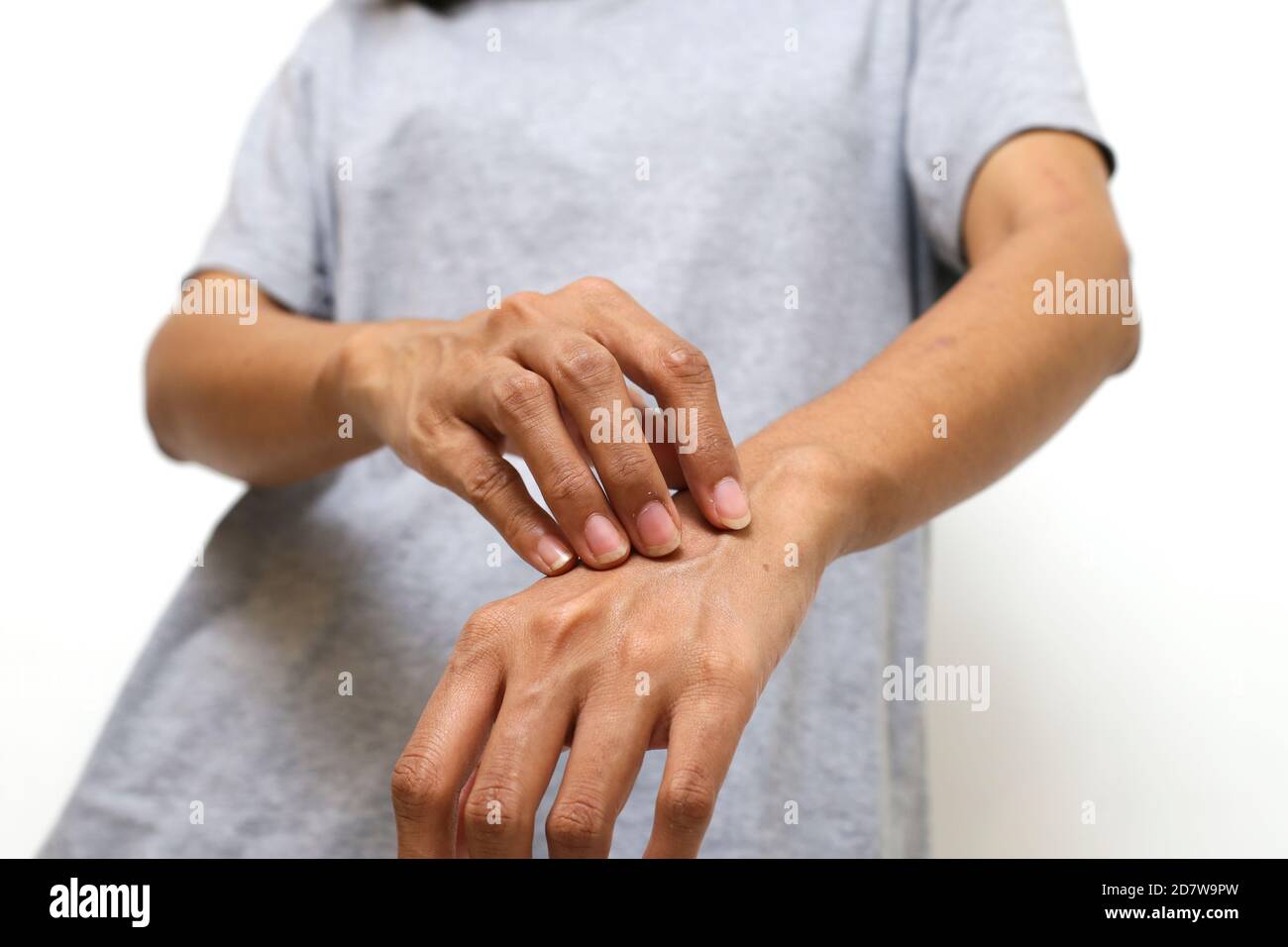 Allergy. Itchy skin. Women's hands are scratched, on white background ...