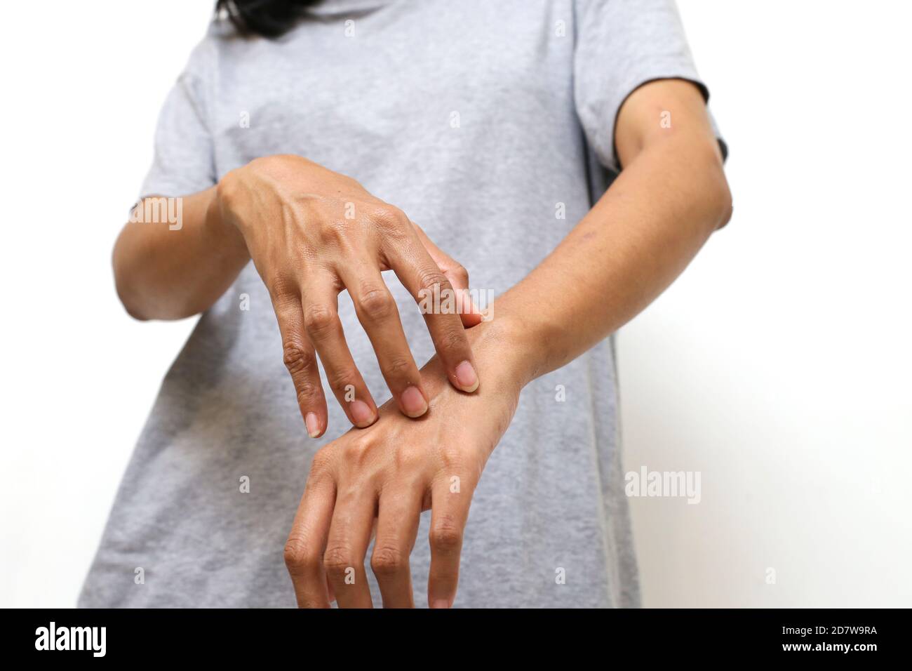 Allergy. Itchy skin. Women's hands are scratched, on white background ...