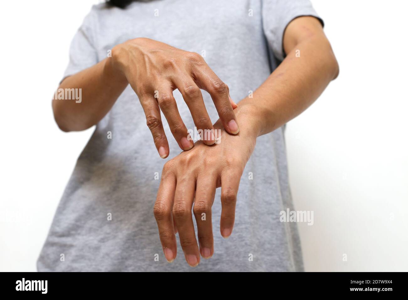 Allergy. Itchy skin. Women's hands are scratched, on white background ...