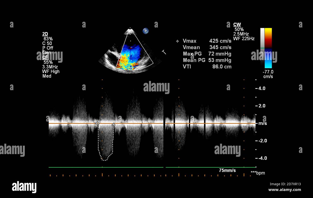 Transesophageal echocardiogram hi-res stock photography and images - Alamy