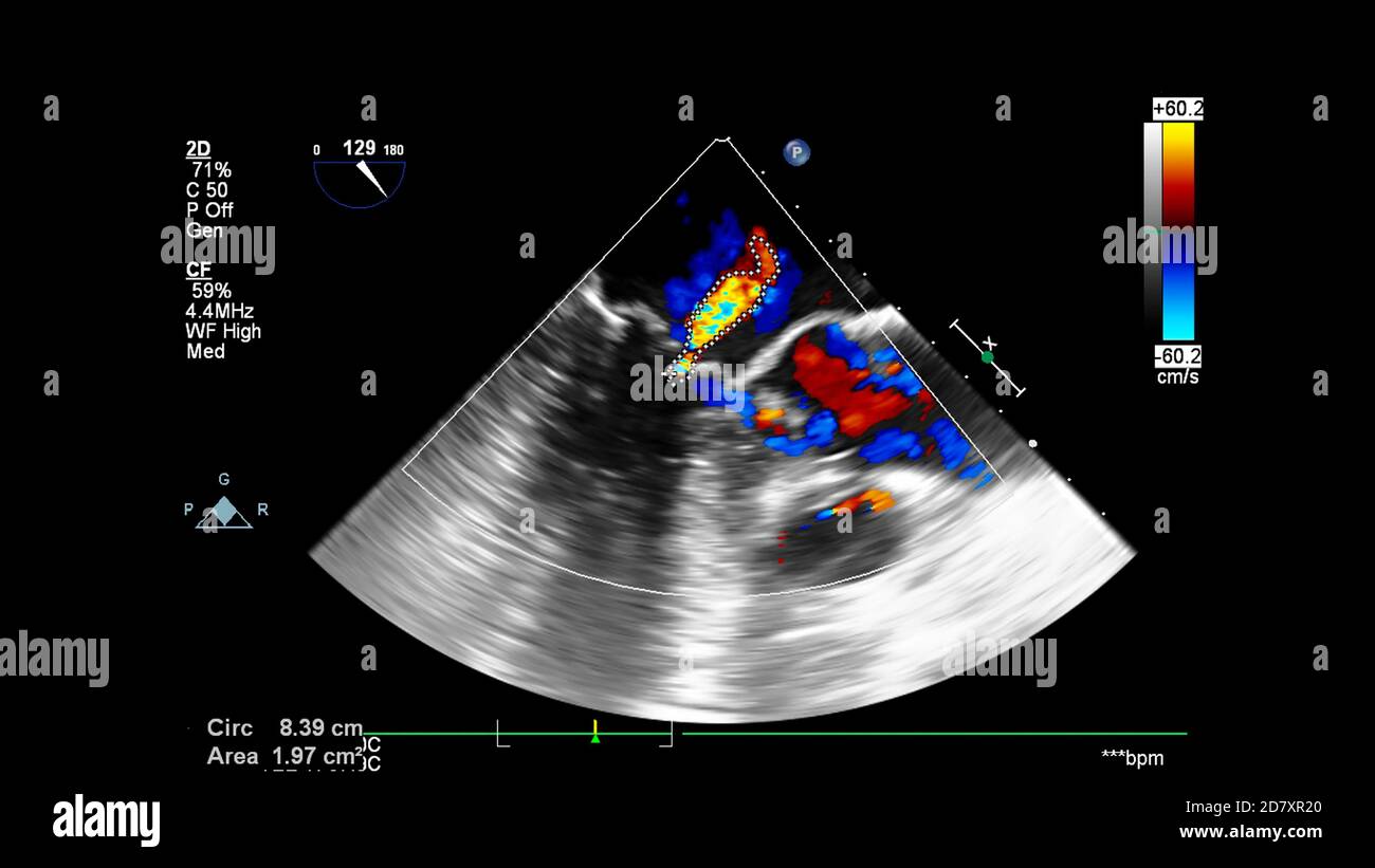 Image of the heart during transesophageal ultrasound with Doppler mode ...