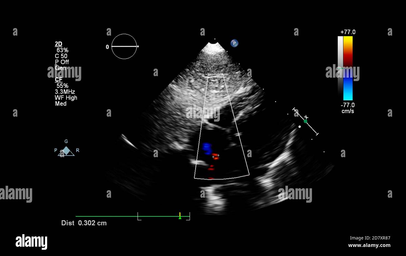 Image of the heart during transesophageal ultrasound with Doppler mode ...
