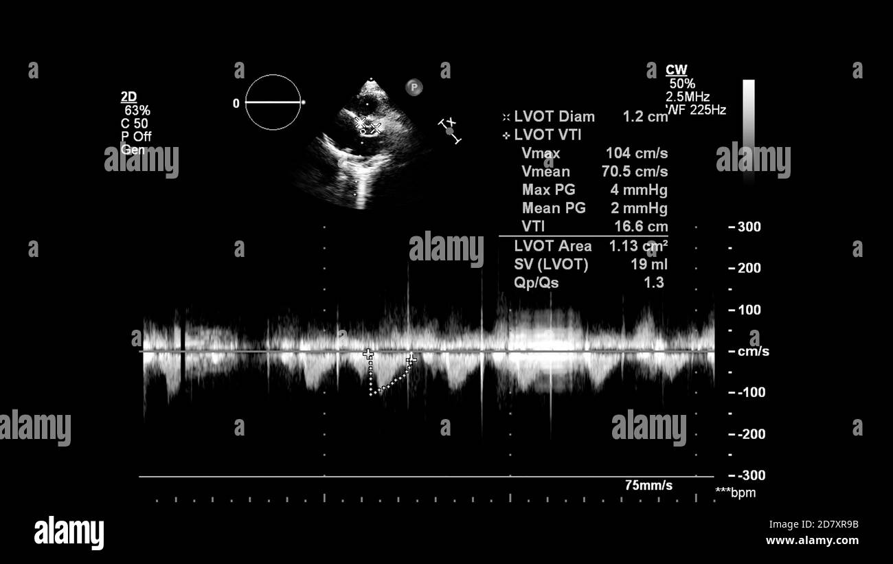 Image of the heart in gray-scale mode during transesophageal ultrasound ...