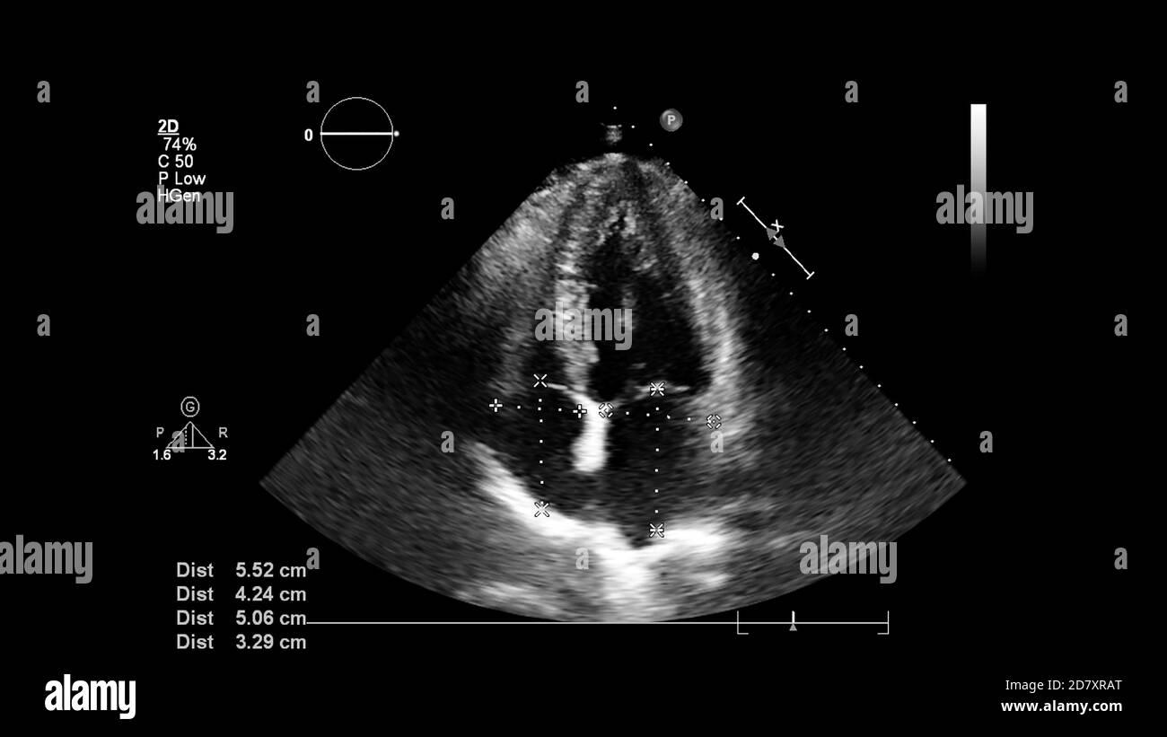 Image of the heart in gray-scale mode during transesophageal ultrasound ...