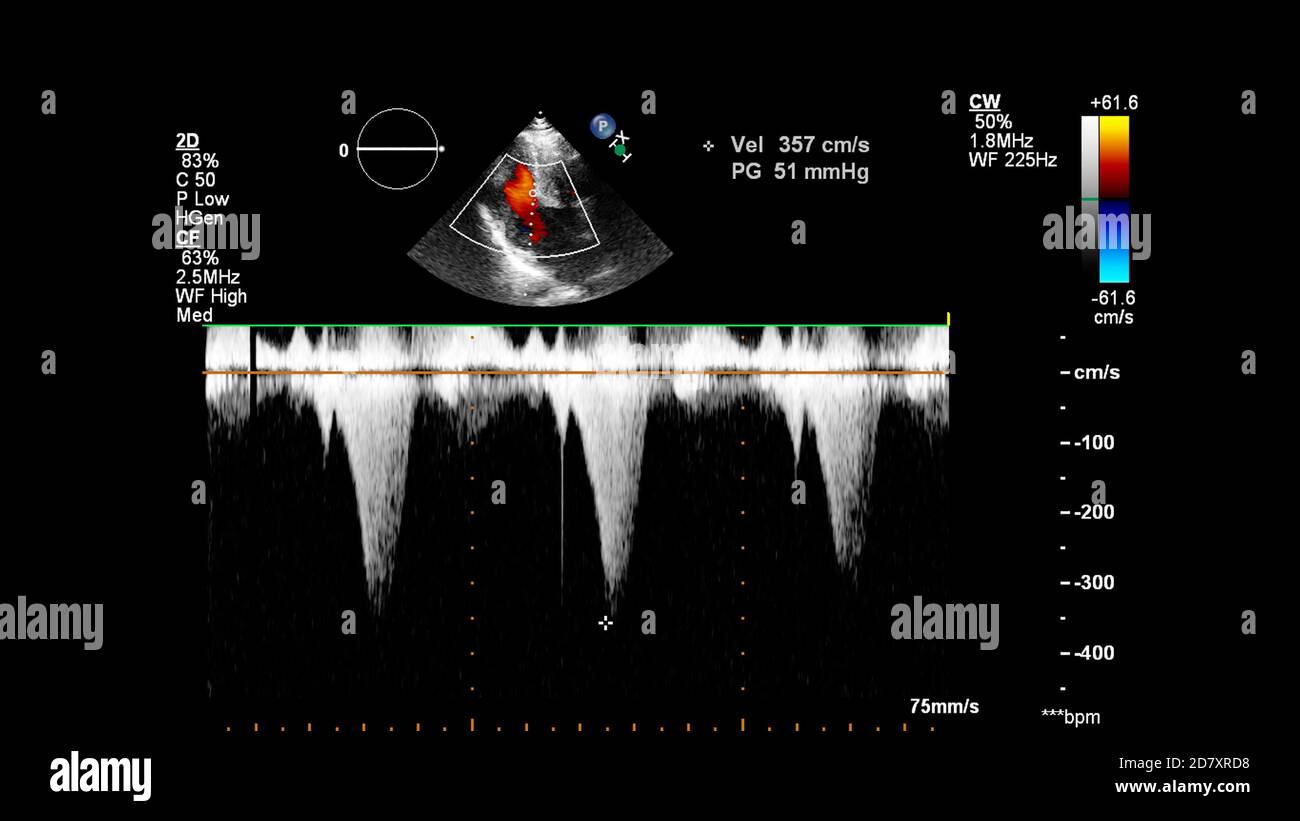 Image of the heart during transesophageal ultrasound with Doppler mode ...