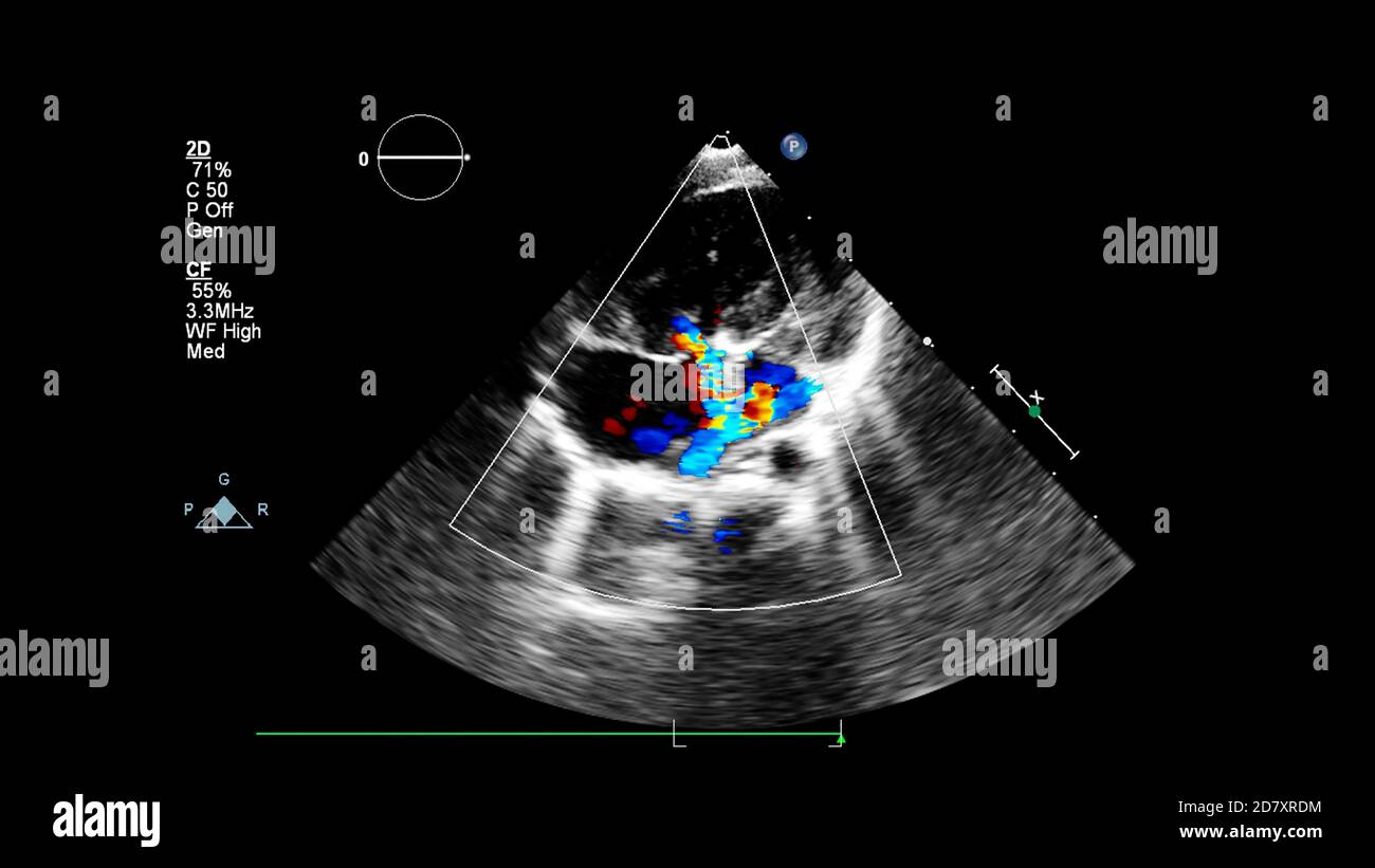 Image of the heart during transesophageal ultrasound with Doppler mode ...