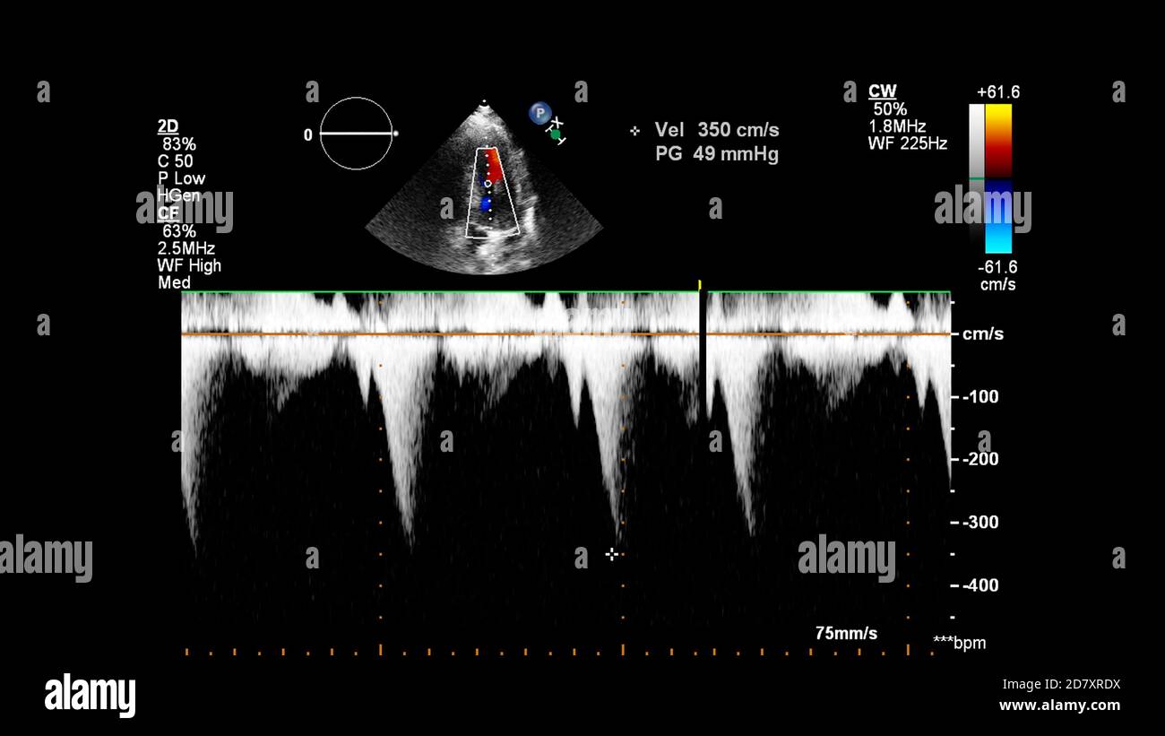 Transesophageal echocardiogram hi-res stock photography and images - Alamy