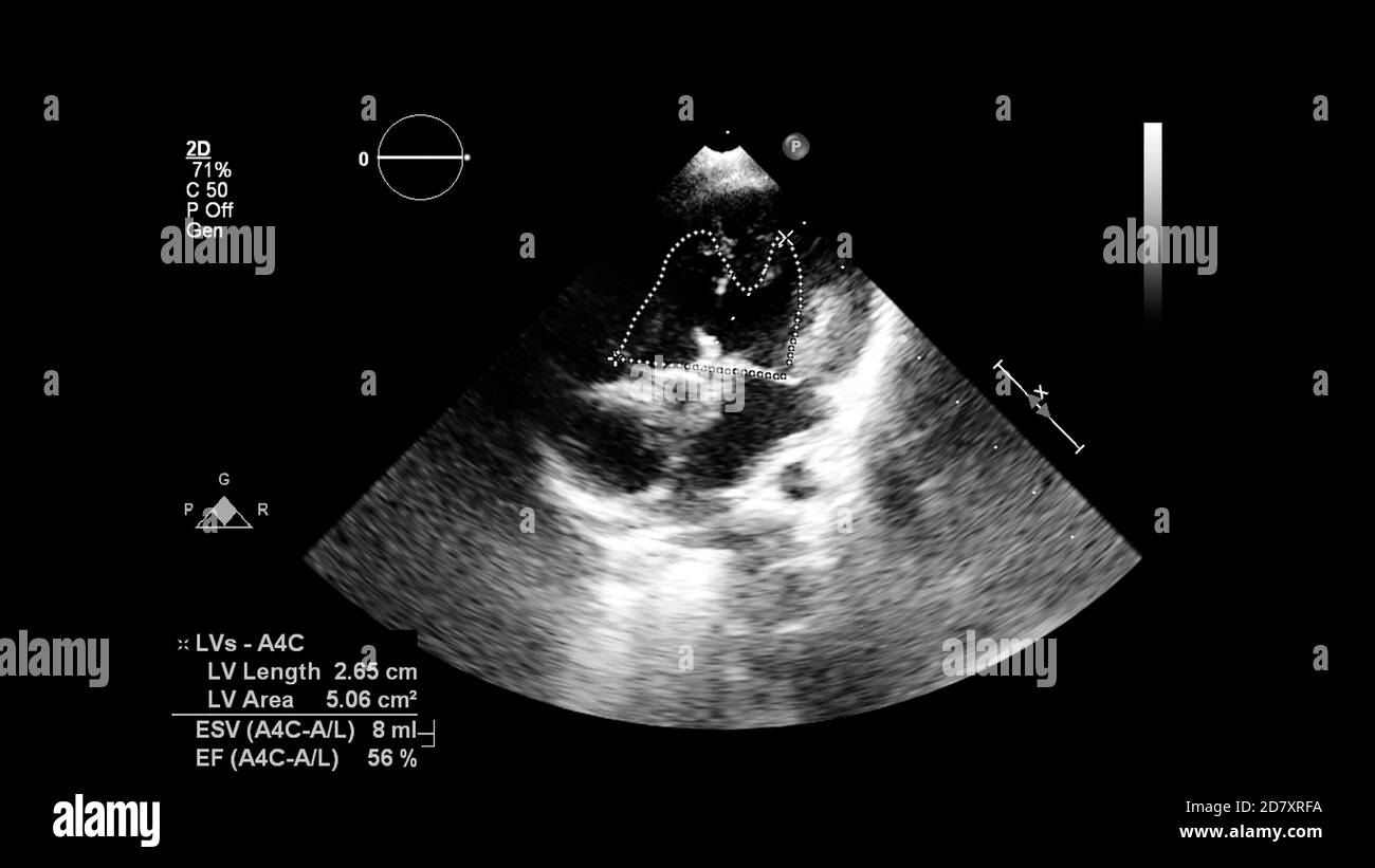 Image of the heart in gray-scale mode during transesophageal ultrasound ...