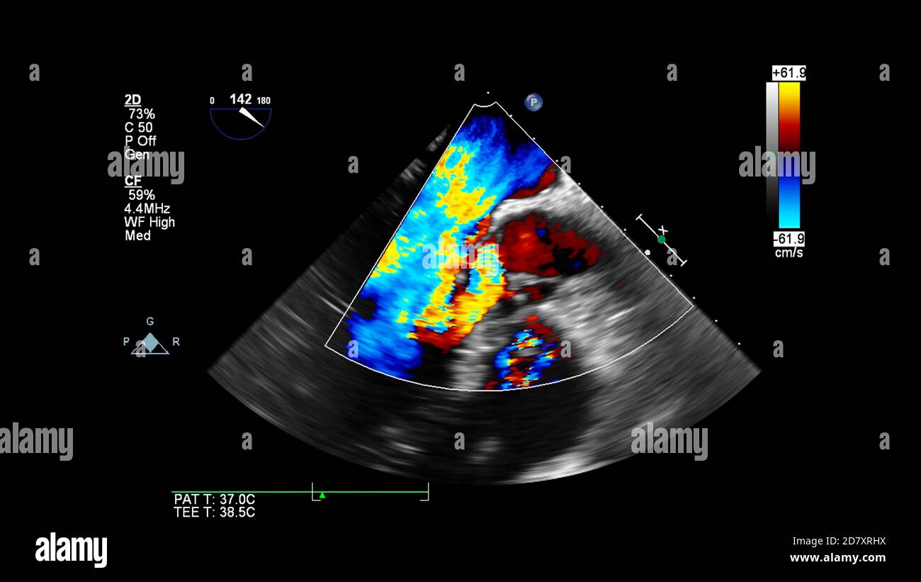 Image of the heart during transesophageal ultrasound with Doppler mode ...