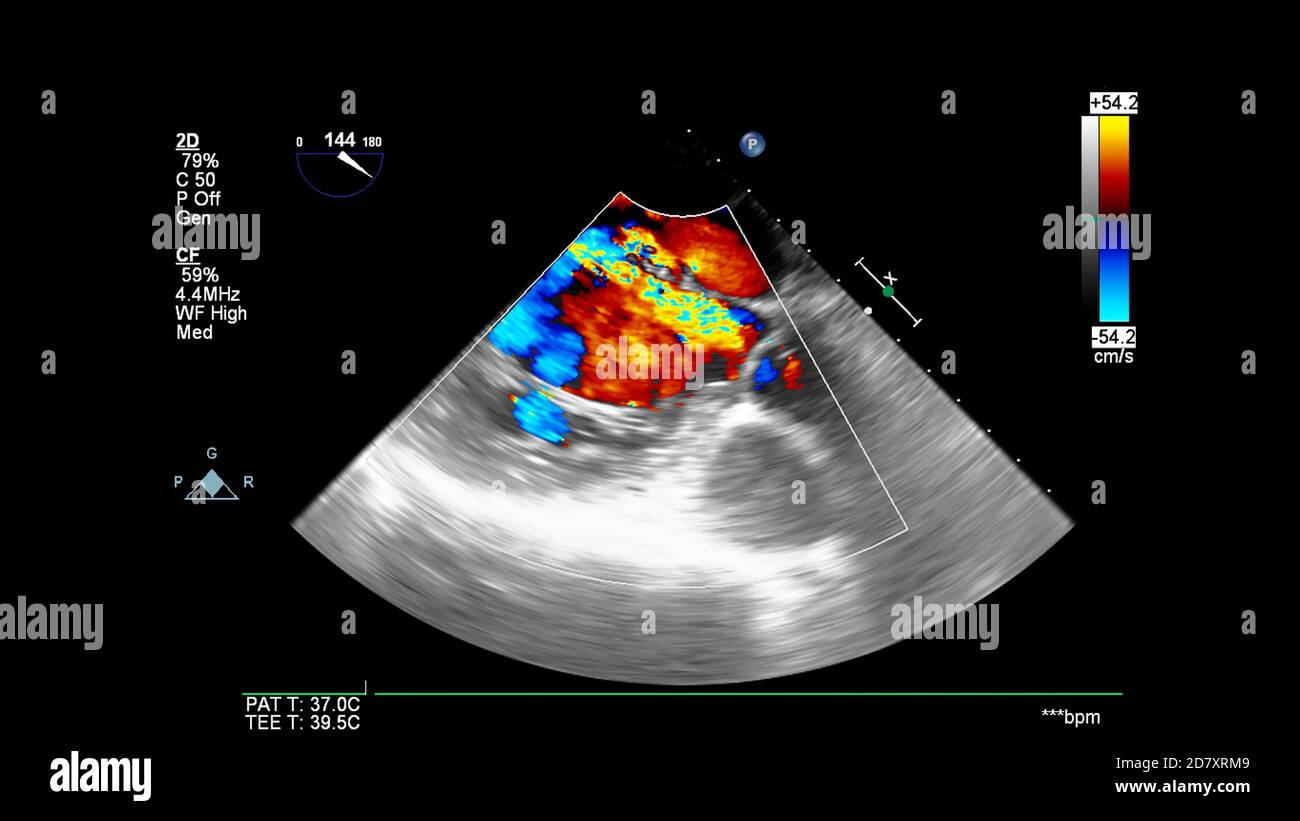 Image of the heart during transesophageal ultrasound with Doppler mode ...