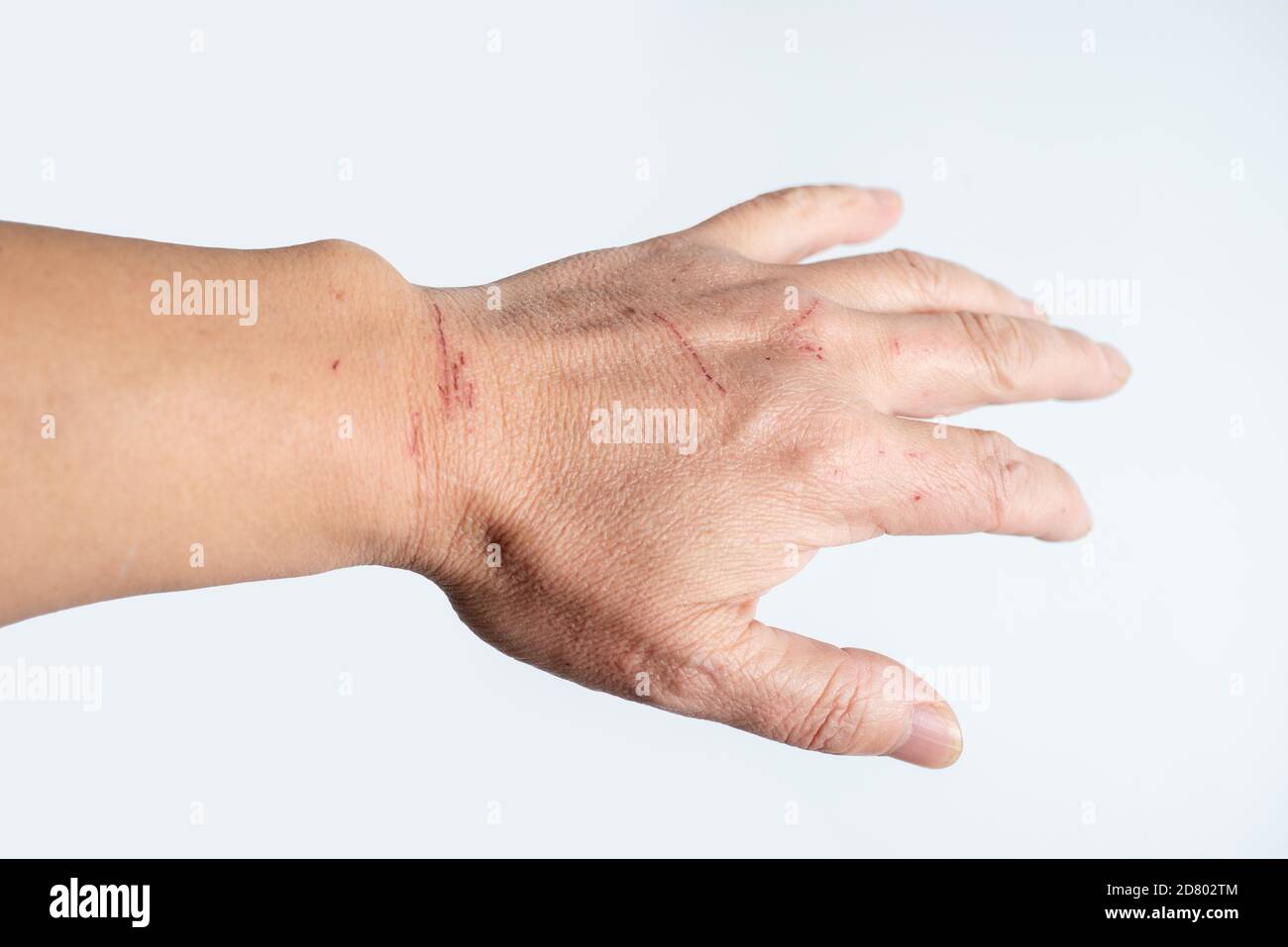 Scar hand hi-res stock photography and images - Alamy