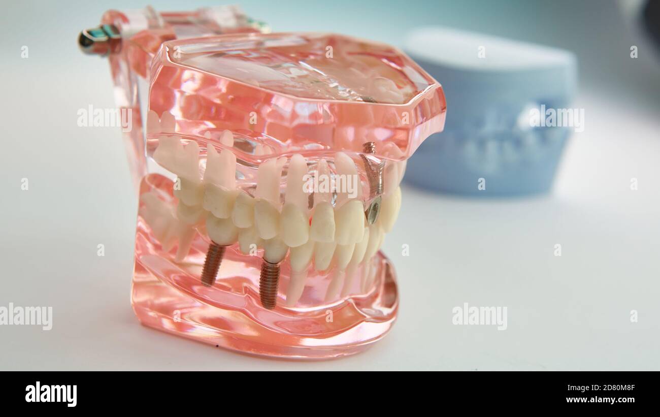 Dental model on the table close-up. Acrylic dental model on the table ...