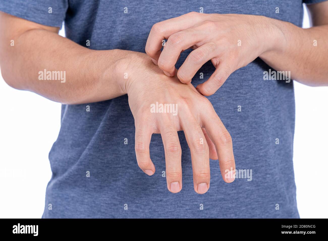 Male scratching his hand isolated white background. Medical, healthcare ...