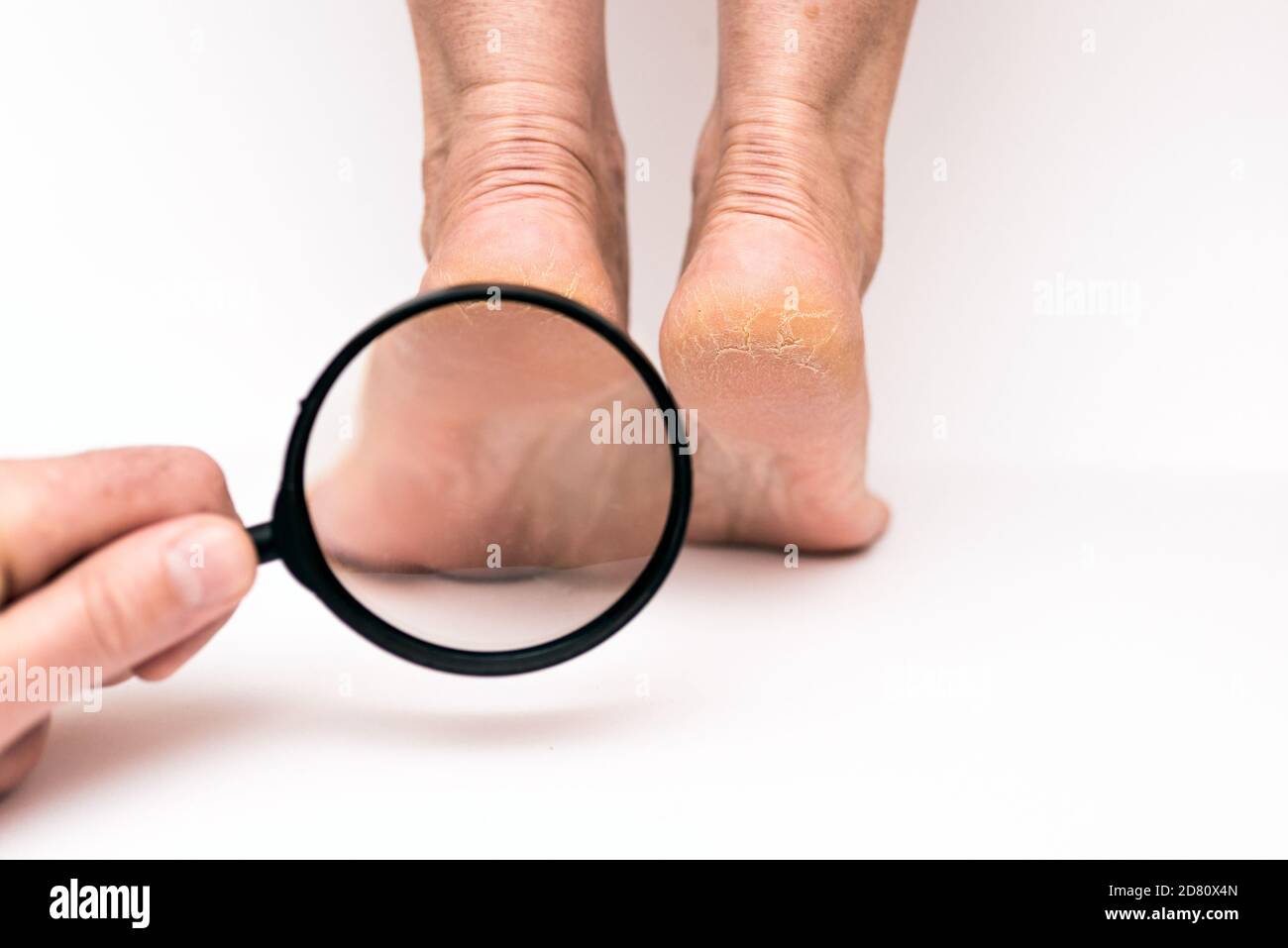 Skin crack woman hi-res stock photography and images - Alamy