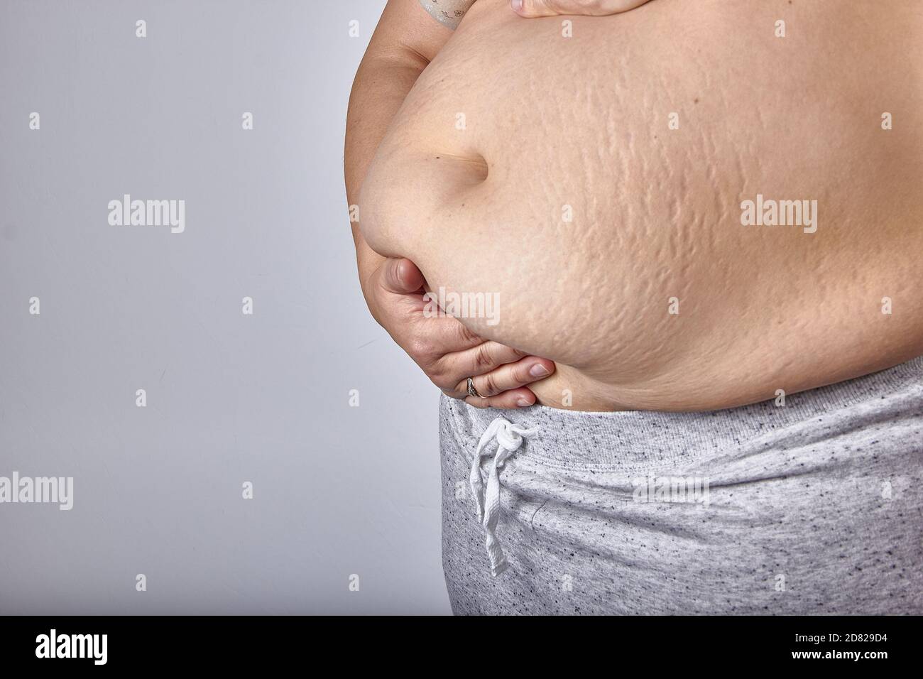 female belly after childbirth, excess fat and stretched skin Stock ...