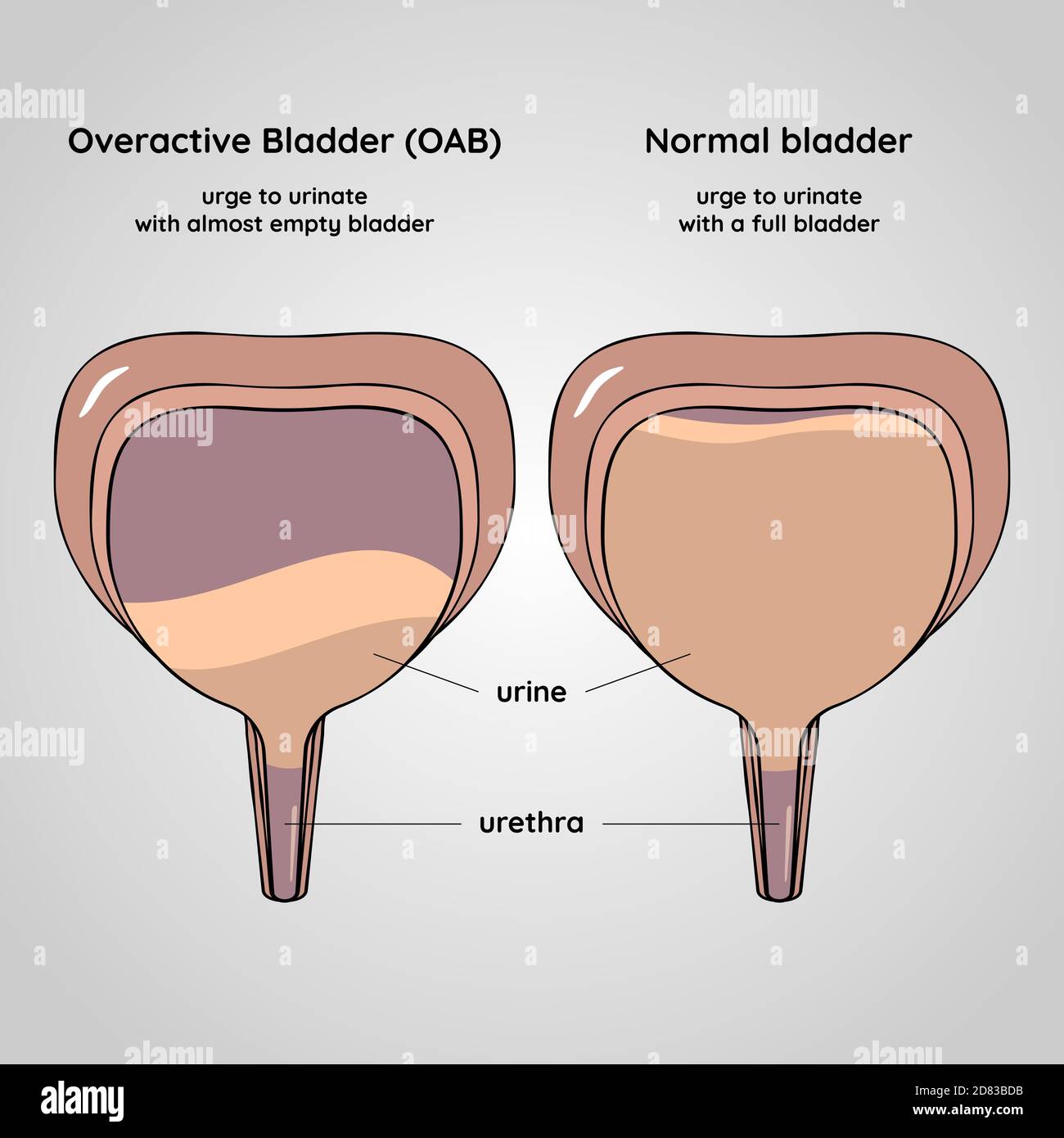 Overactive and normal bladder. Urinary system disease. Urology. Medical flat vector illustration ...