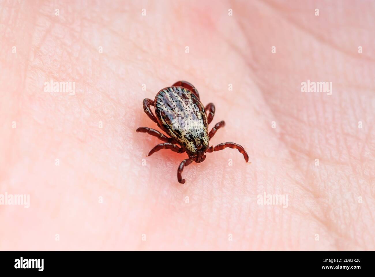 Lyme Disease Infected Tick Mite Insect Crawling on Skin. Encephalitis ...