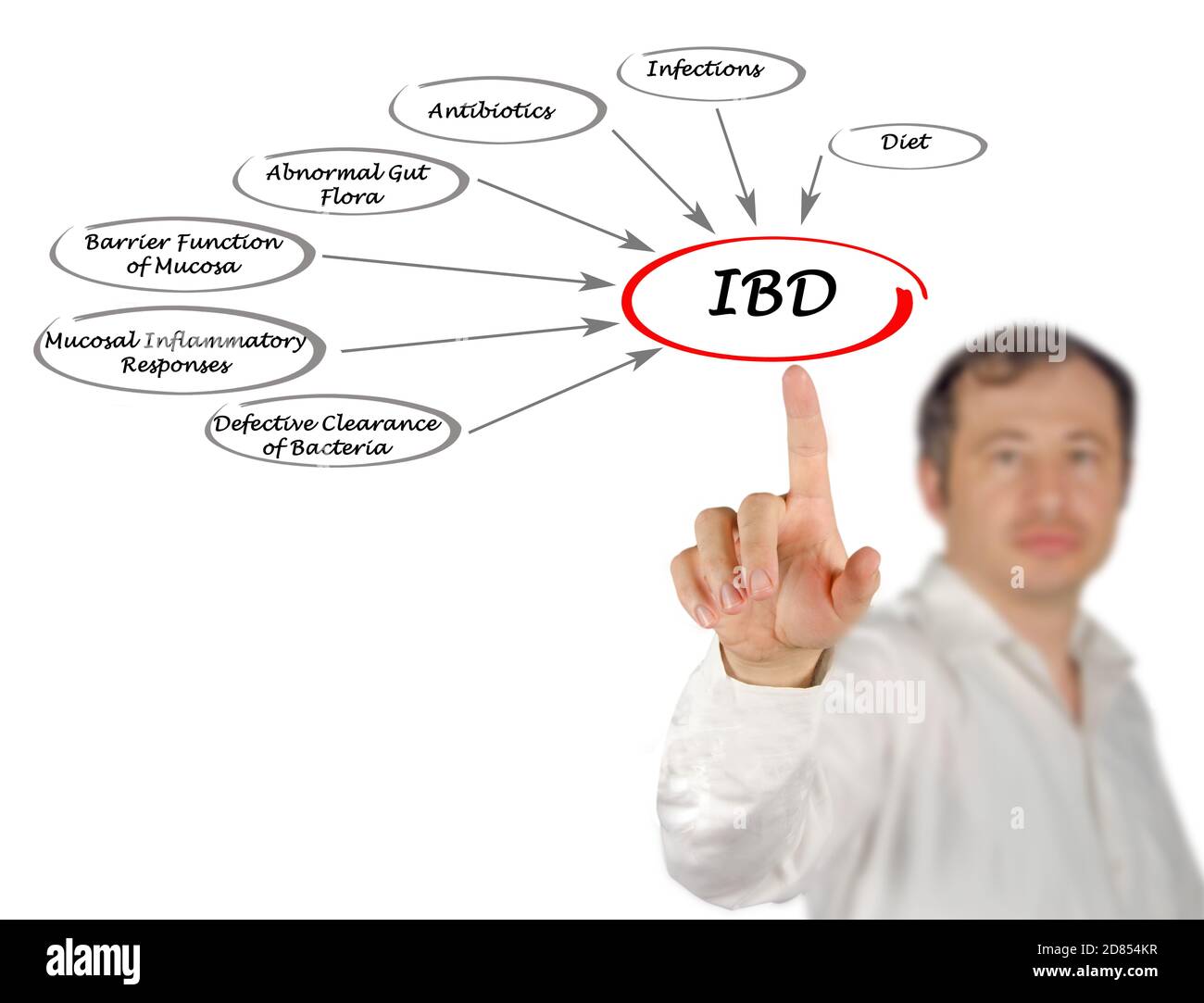 Causes of Inflammatory bowel disease Stock Photo - Alamy