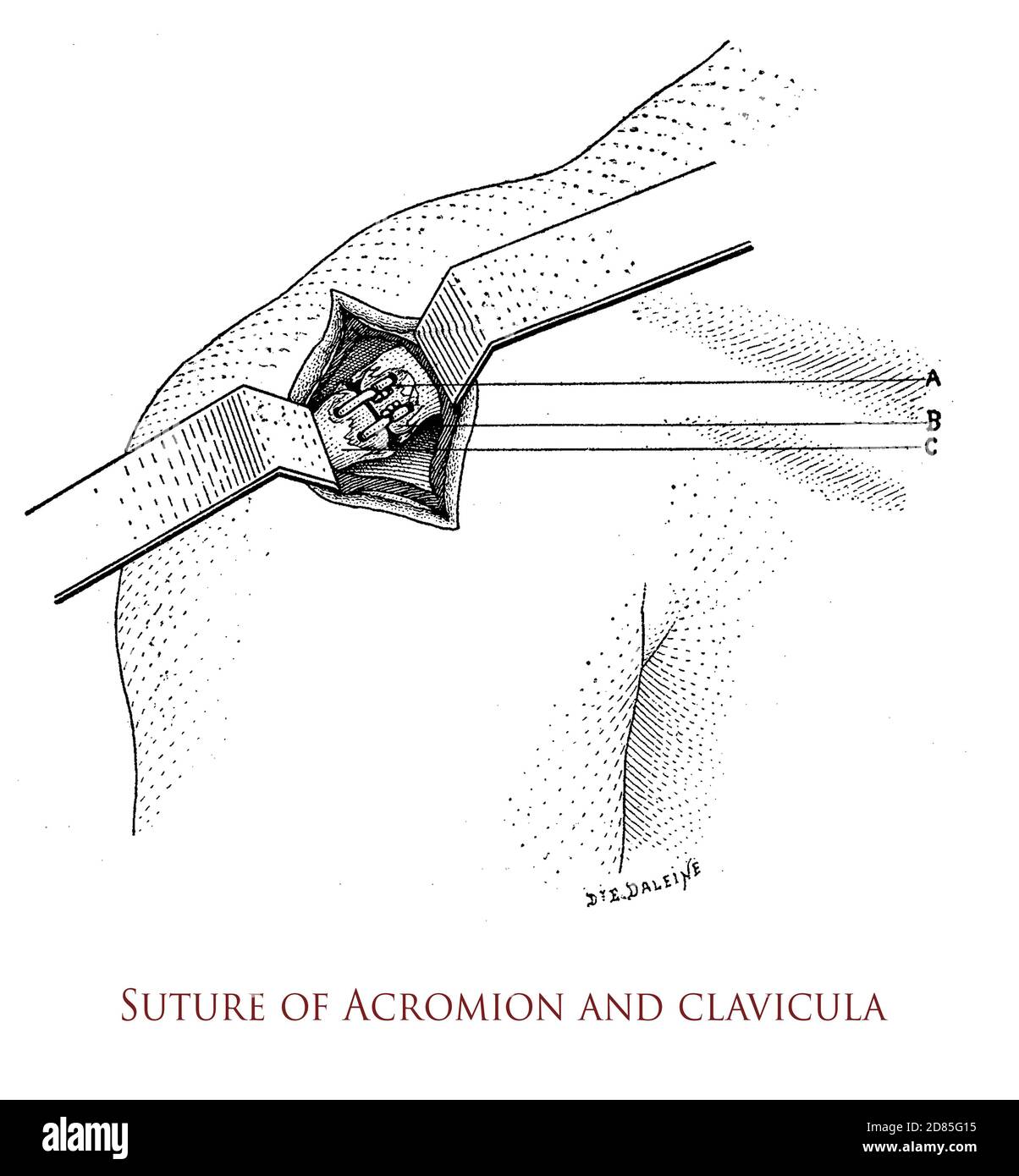 Healthcare and medicine vintage illustration: surgical suture of ...