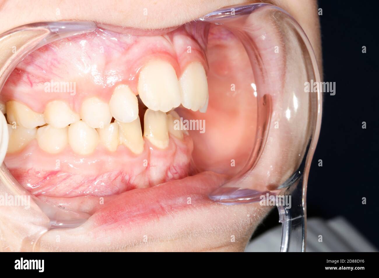 Human intraoral teeth hi-res stock photography and images - Alamy