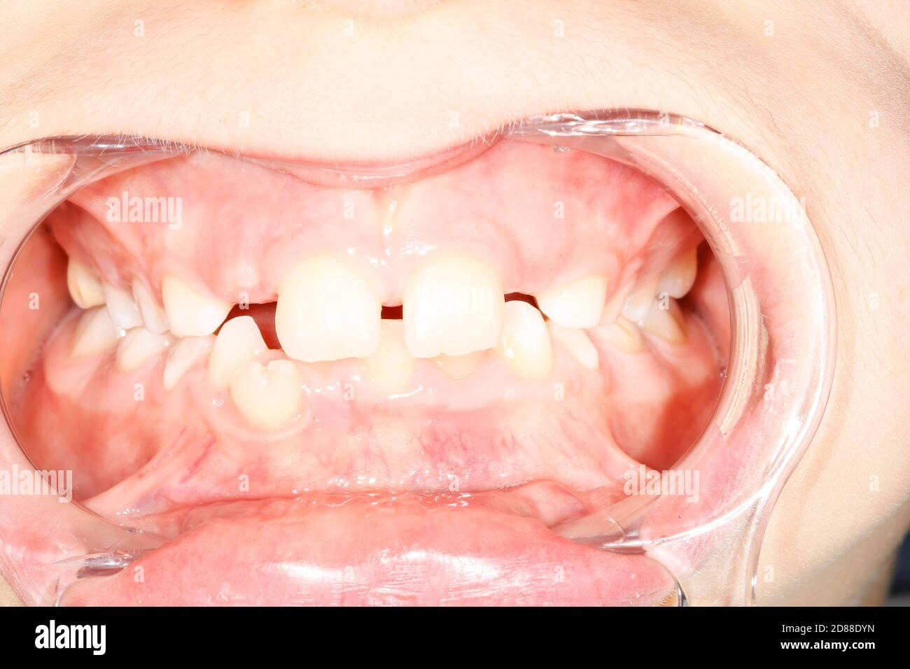 Open child mouth with missing tooth macro. Dental doctor check state of ...