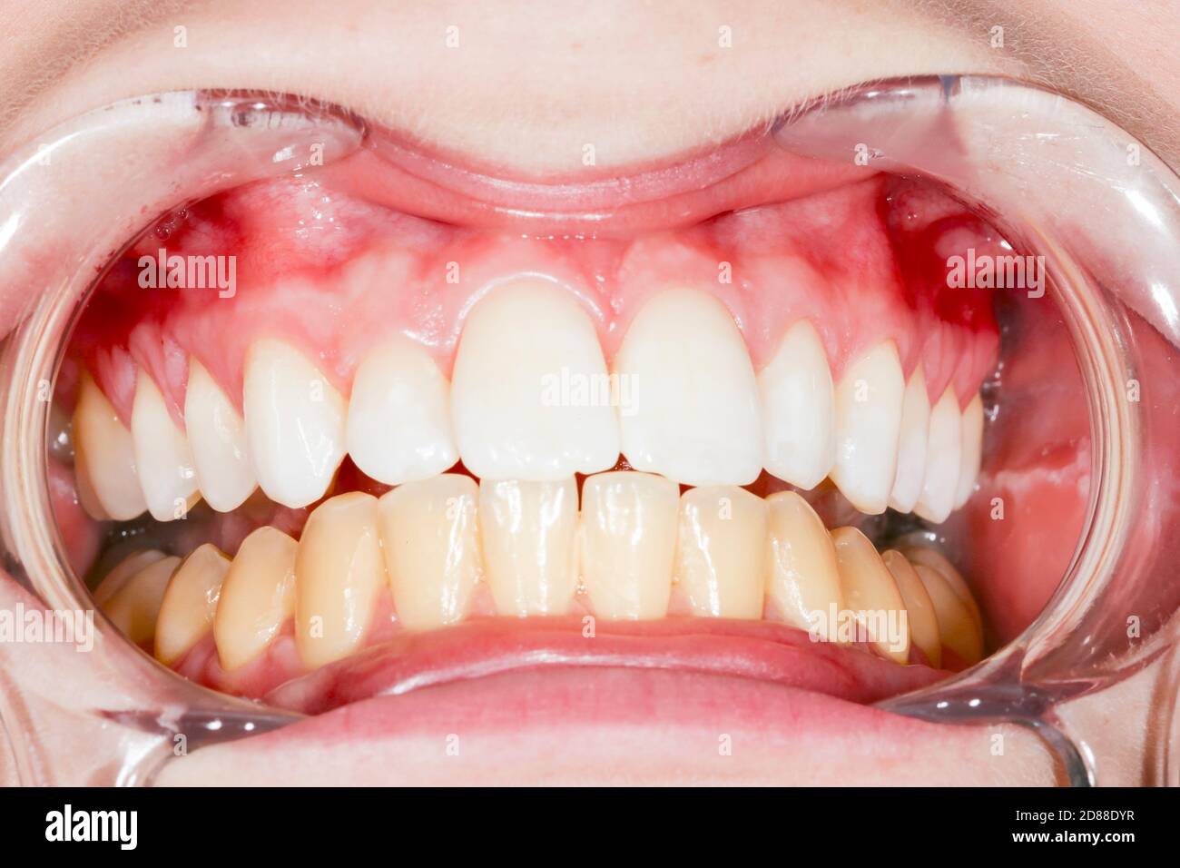 Skin bleaching before after hi-res stock photography and images - Alamy