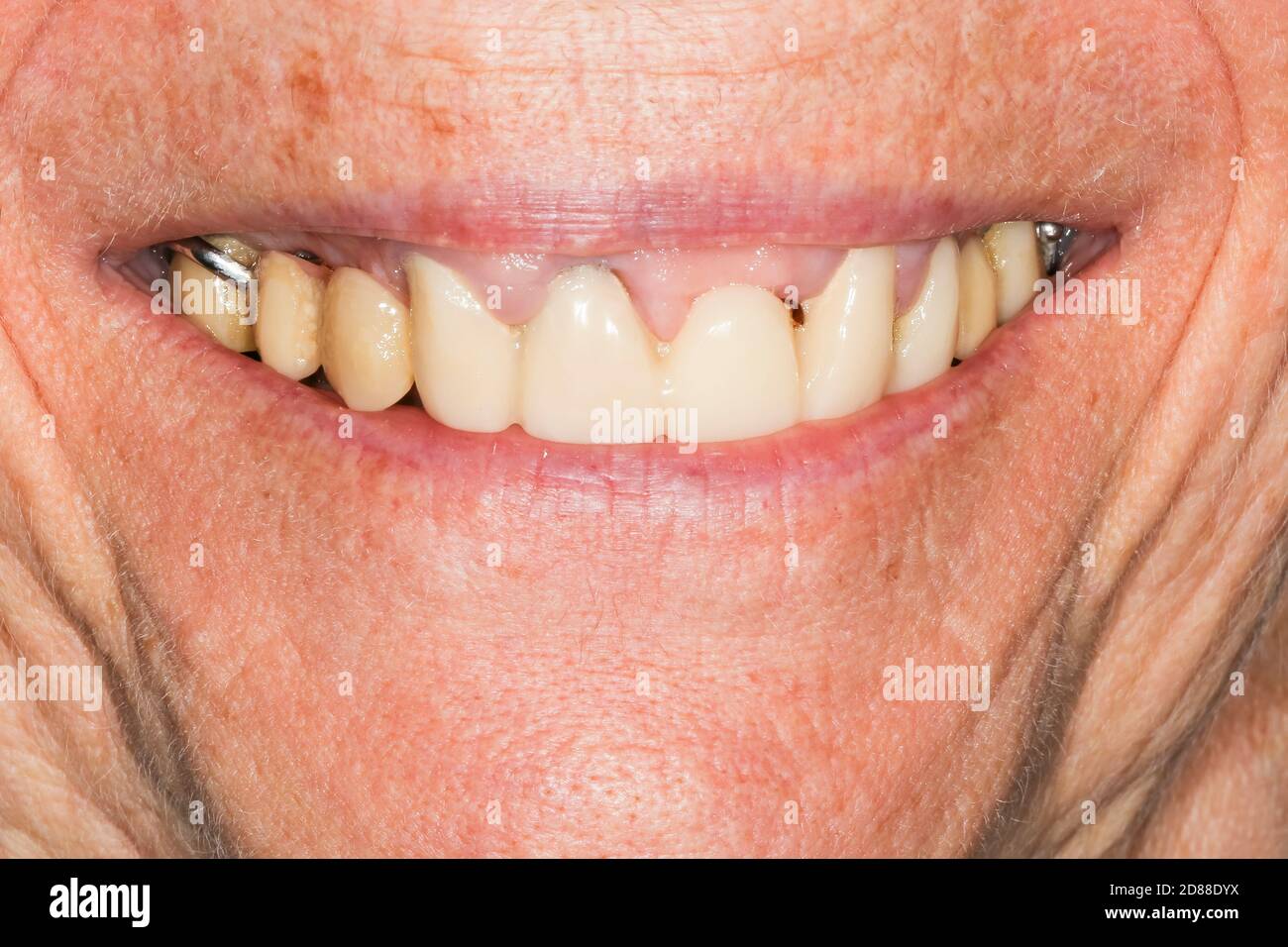 Peri-implantitis : Diseases that cause loss of bone around the dental ...