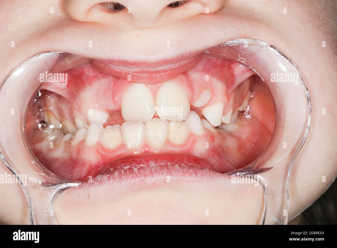 Dental displacement, which needs orthodontic treatment, at dental ...