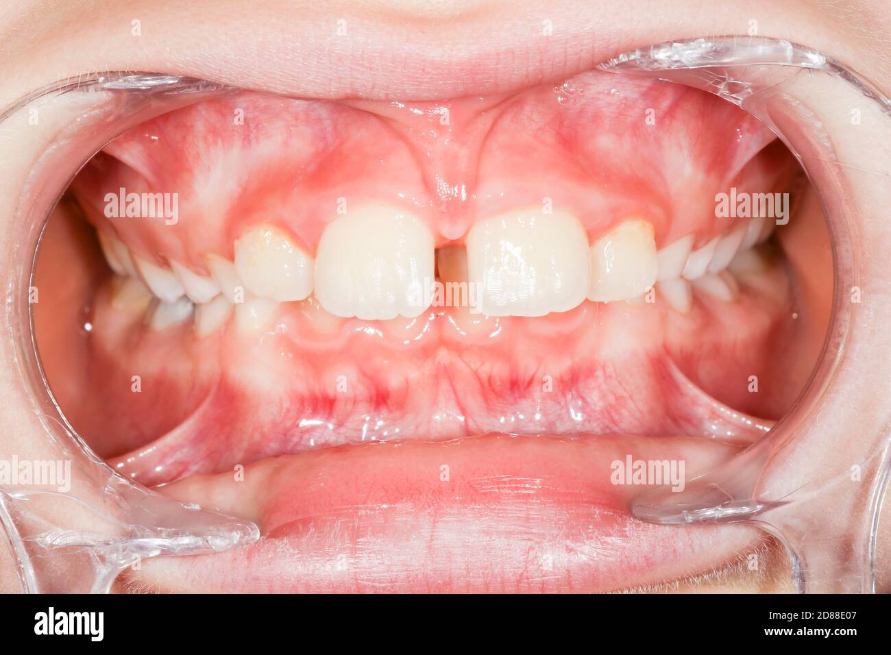 Open child mouth with missing tooth macro. Dental doctor check state of ...