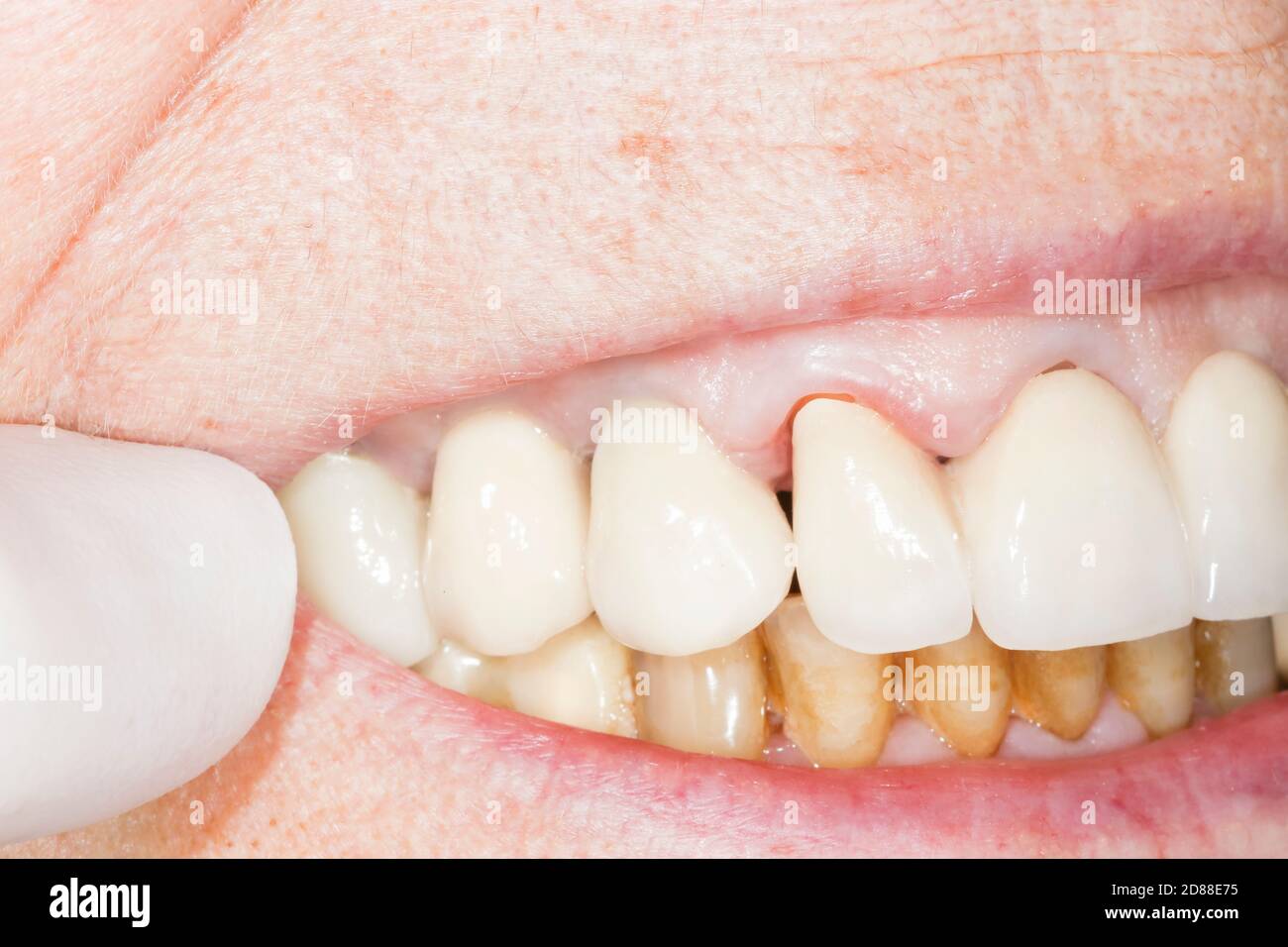 woman teeth before and after whitening. Imperfect dentition. Up done ...