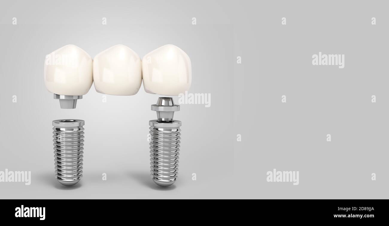 Tooth human multitooth implant Dental concept Human teeth or dentures ...