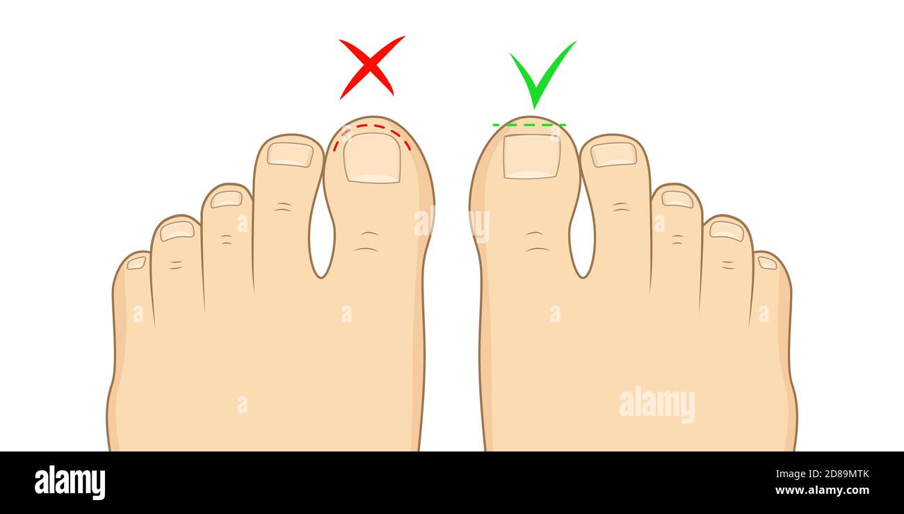 Right to cut toenails. Toe nail pedicure. foot sole vector illustration ...