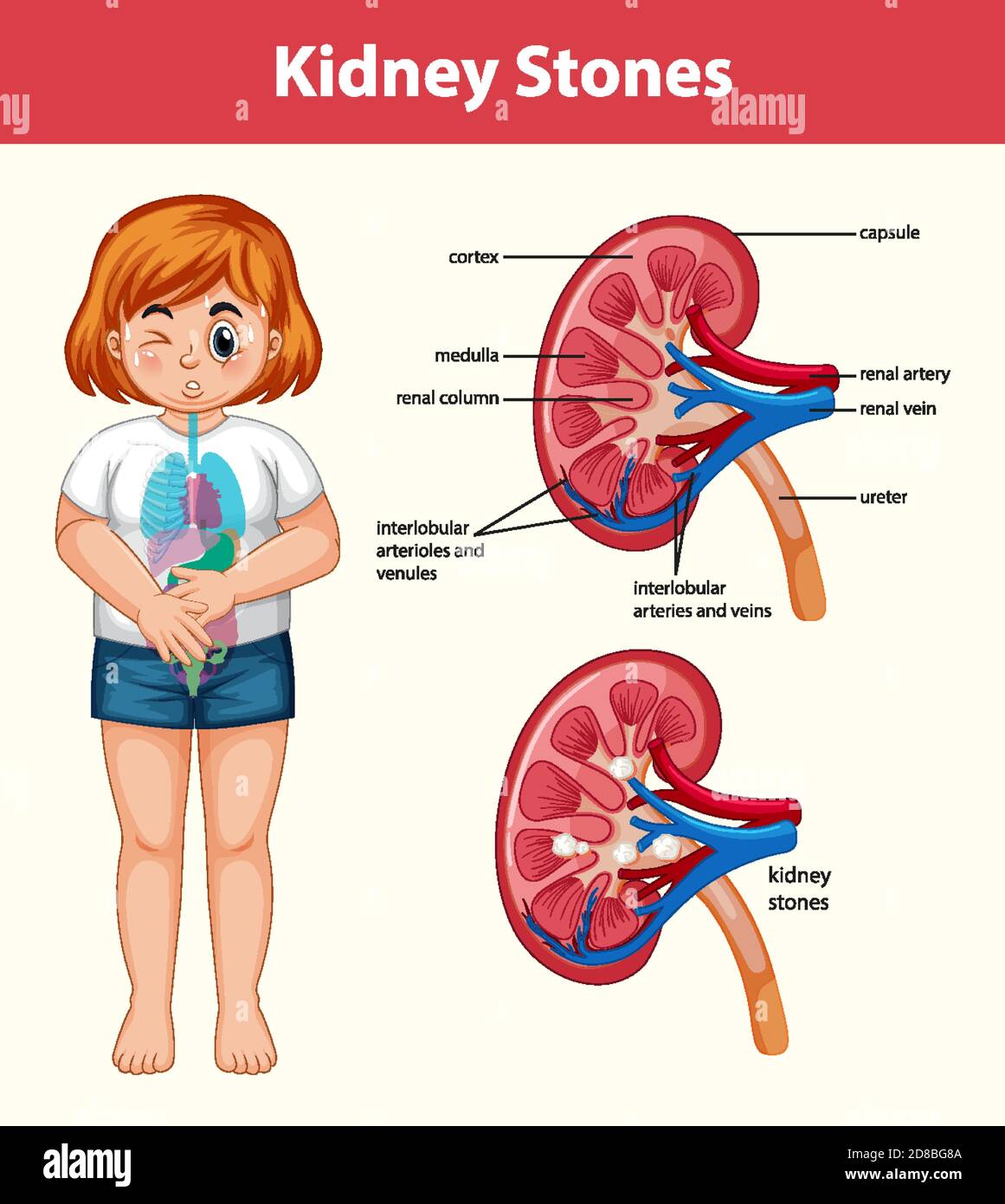 Human kidney stones cartoon style infographic illustration Stock Vector ...