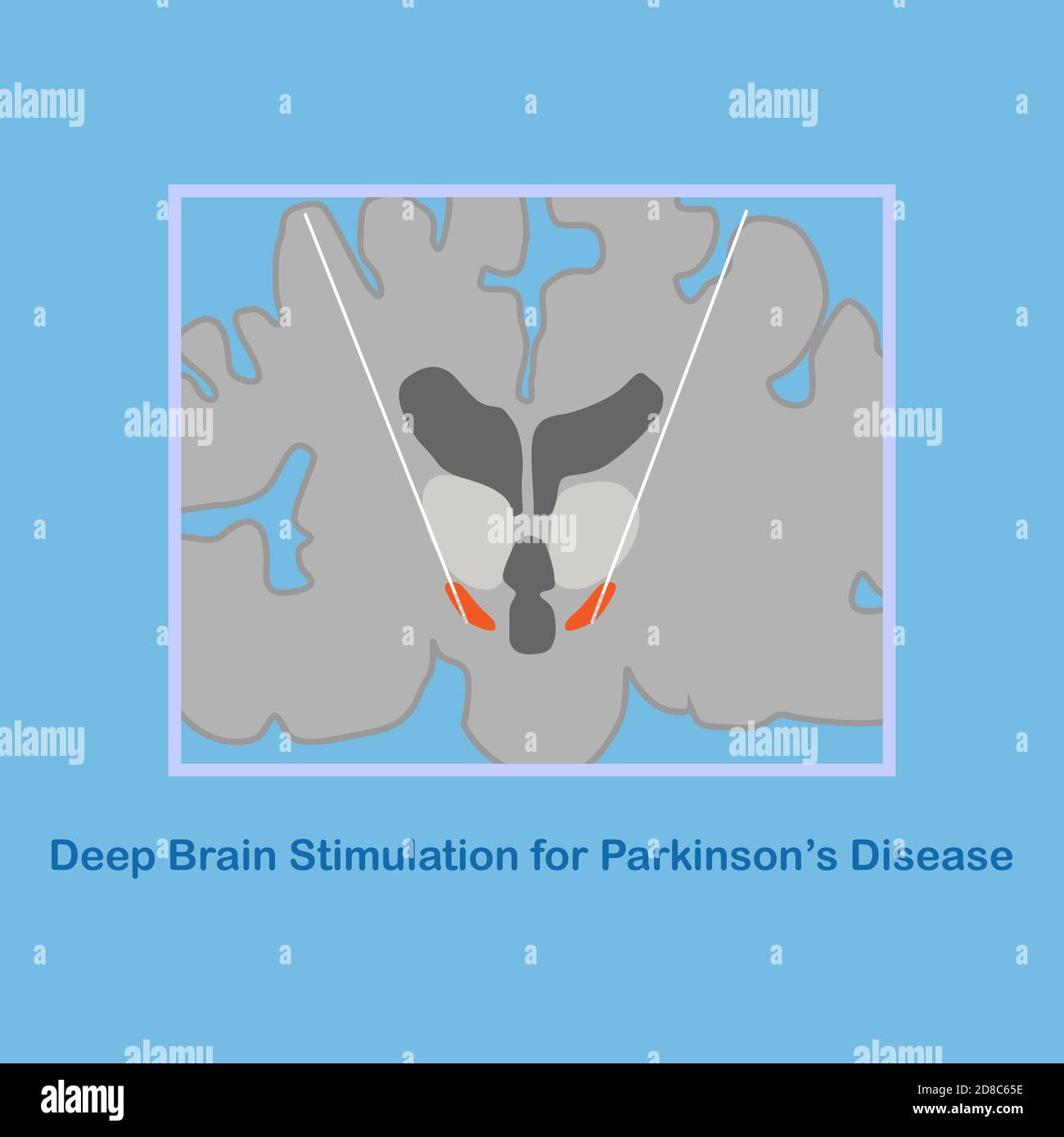 Parkinsons brain stimulation Stock Vector Images - Alamy