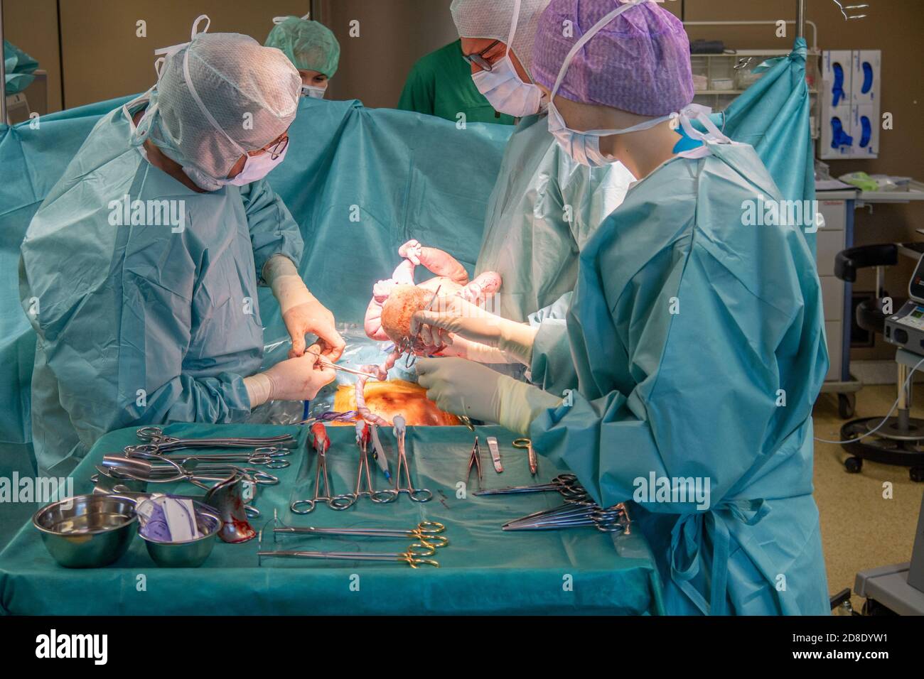 a team of gynecologists performs a caesarean section in an operating ...