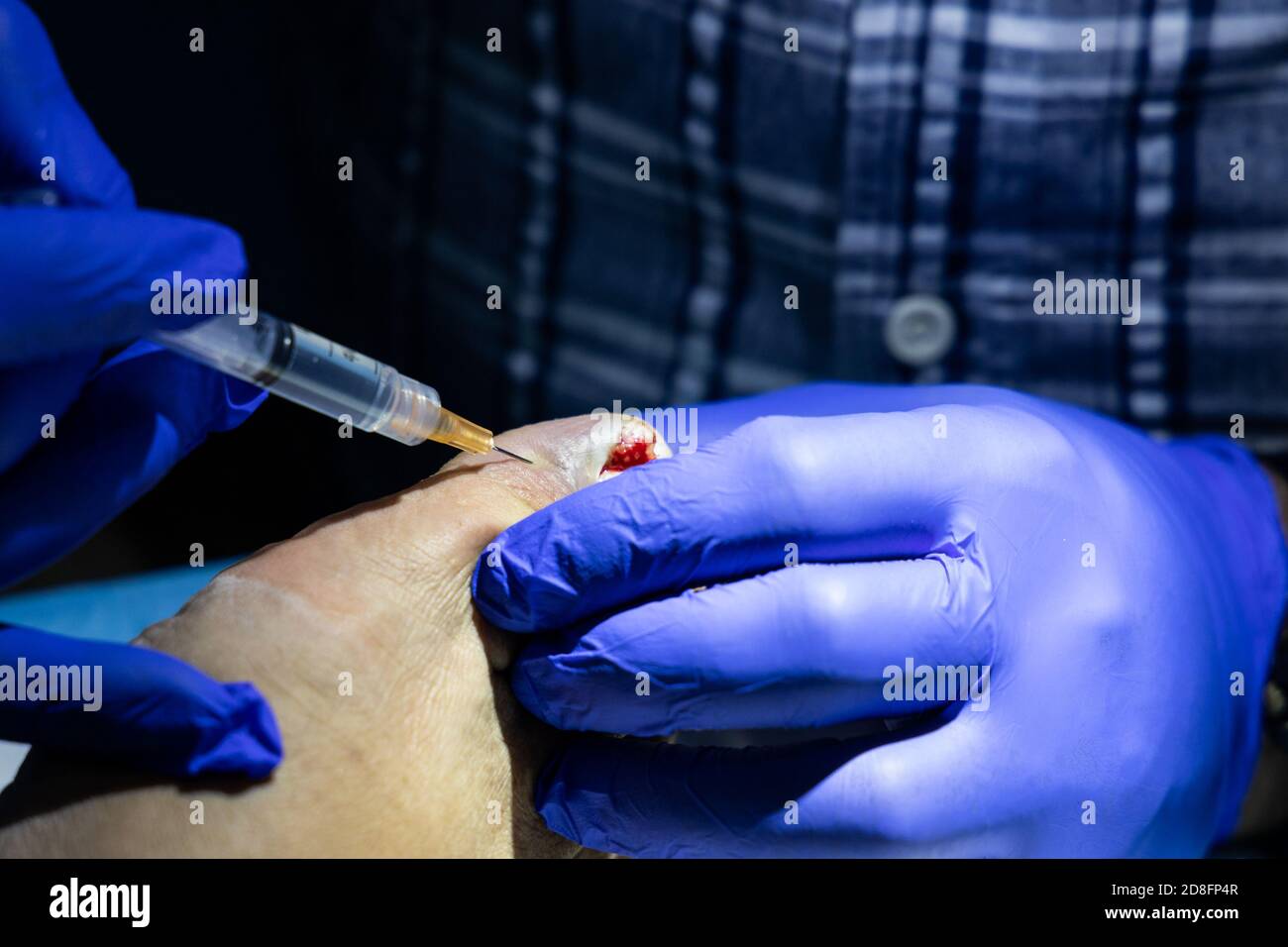 Series of ingrown toenail treatment. Medical doctor injecting local ...
