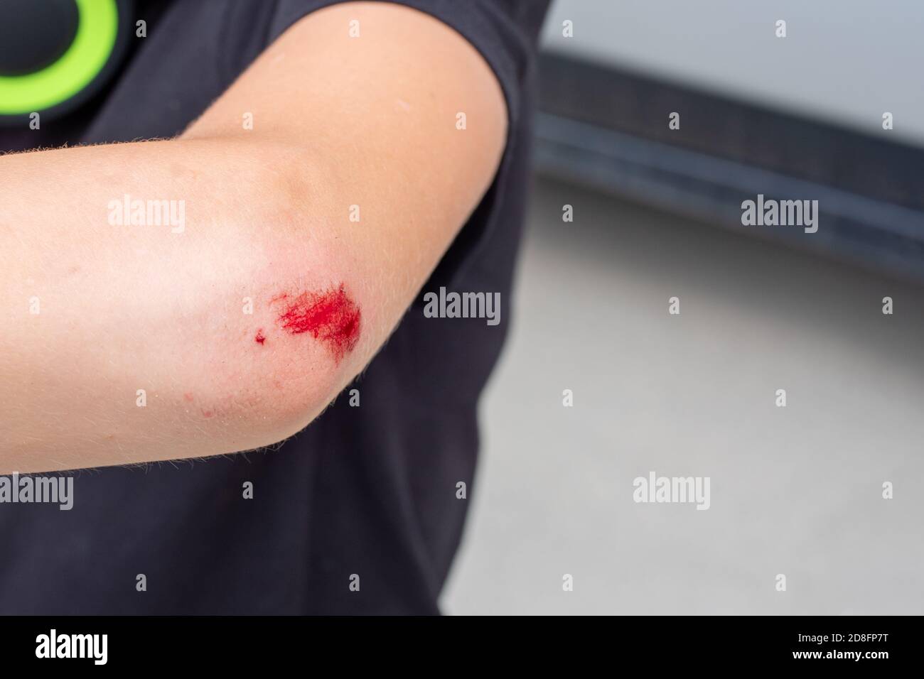 Selective focus of a fresh wound on the arm, elbow with blood. Health ...