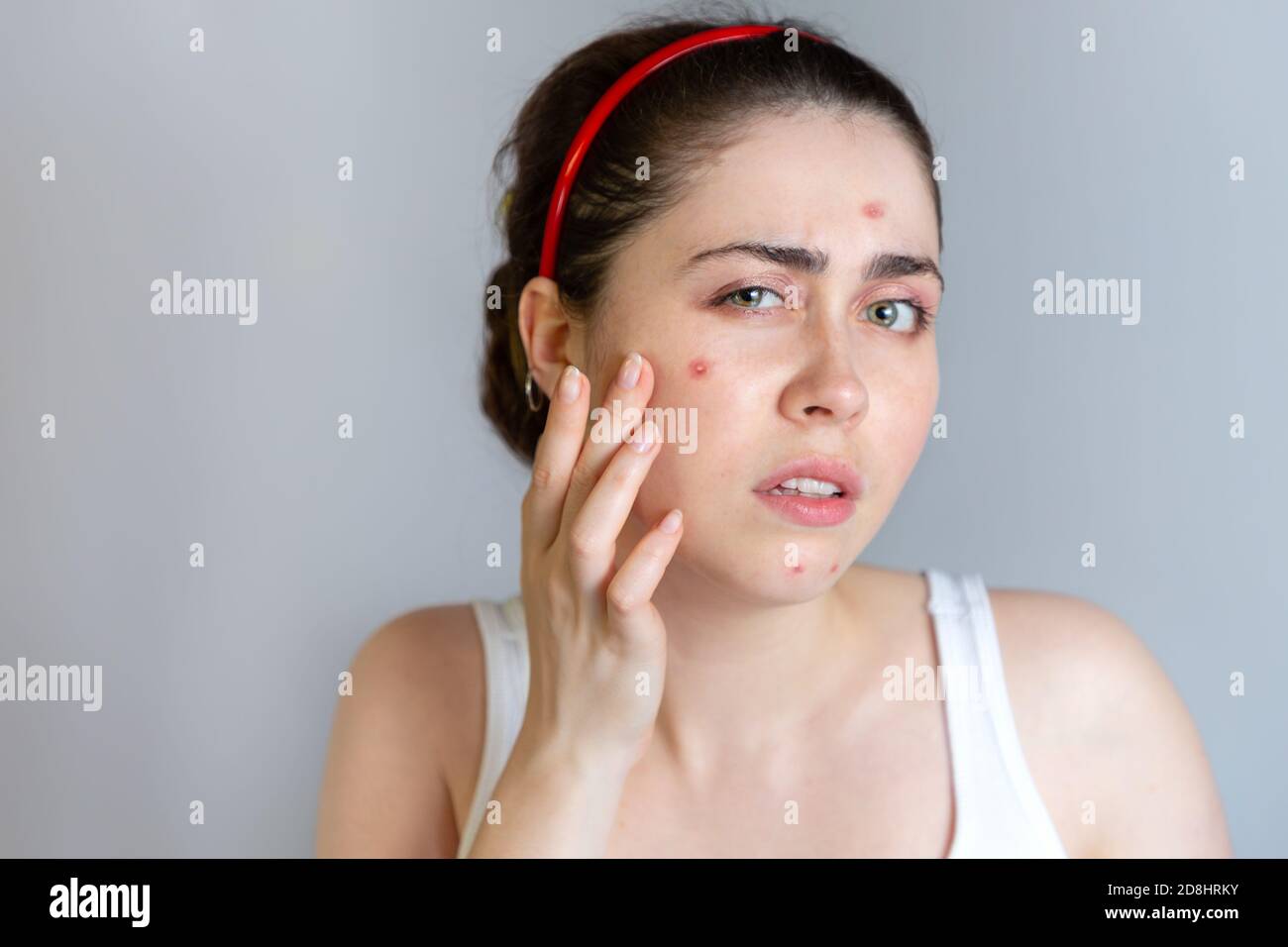 Pimple control hi-res stock photography and images - Alamy