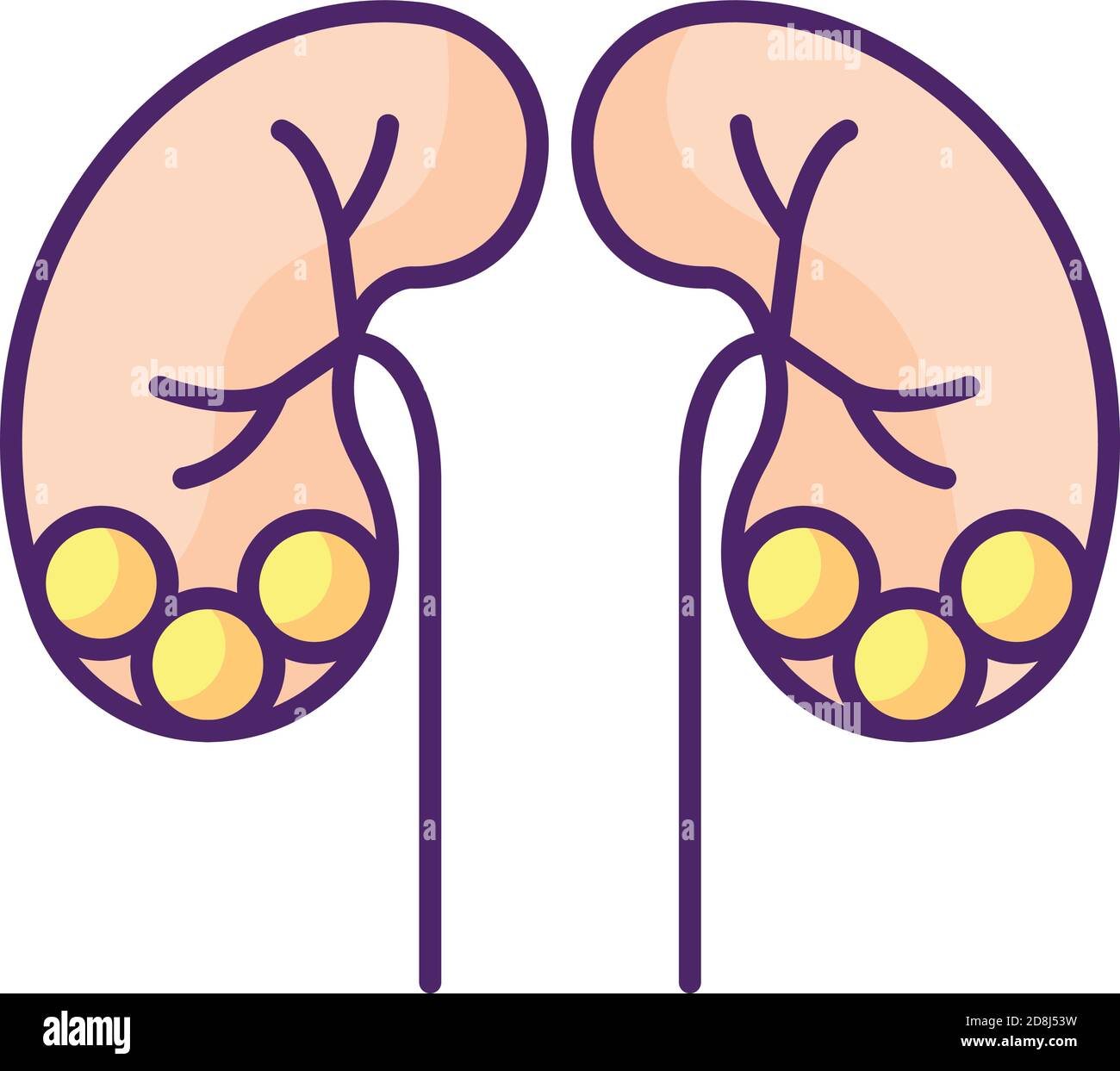 Kidney stone disease renal Stock Vector Images - Alamy