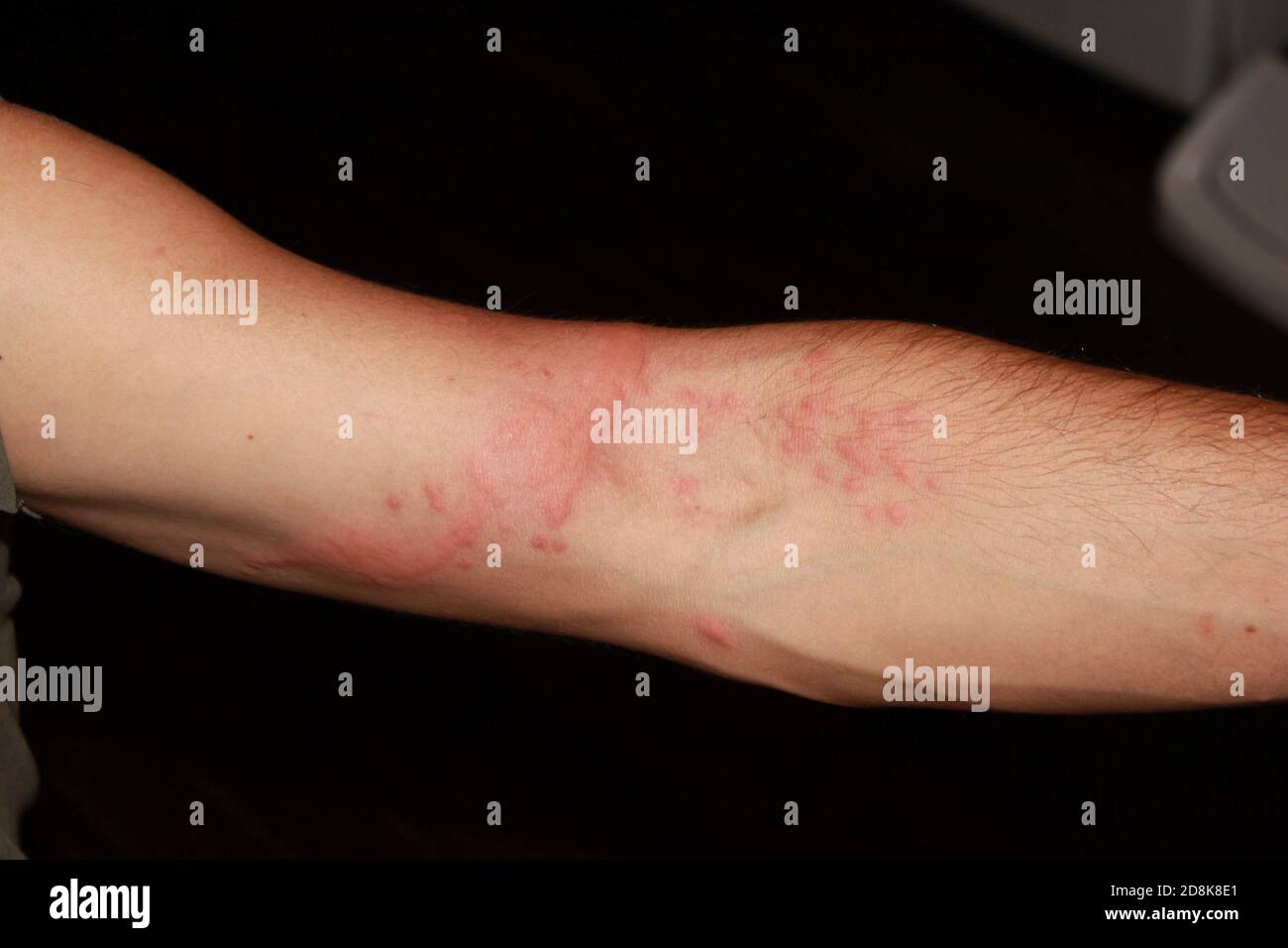 Jellyfish sting skin hi-res stock photography and images - Alamy