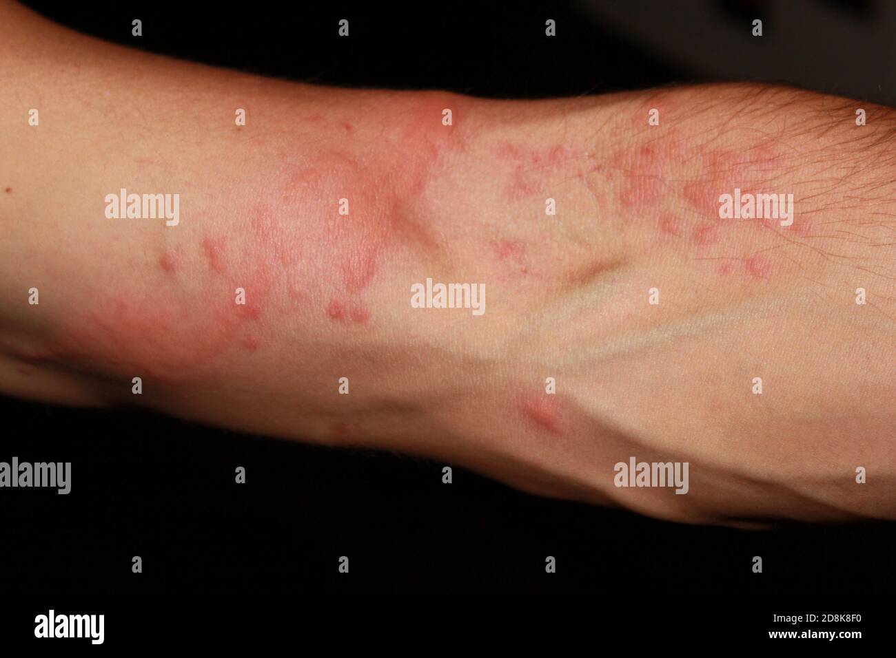 Painful bites hi-res stock photography and images - Alamy