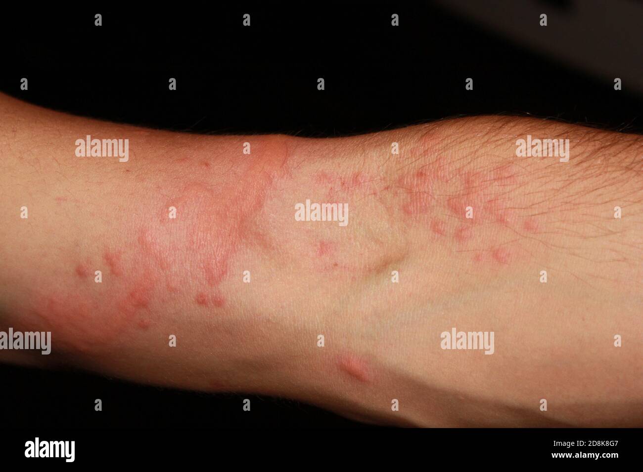 Jelly fish bites on body Stock Photo - Alamy