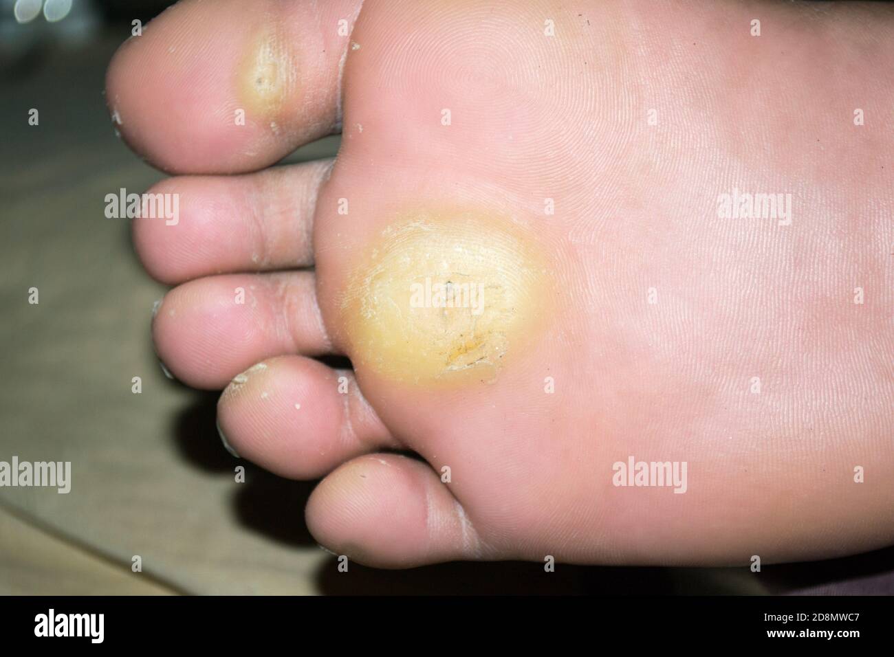 A callus is an area of thickened skin that forms as a response to ...