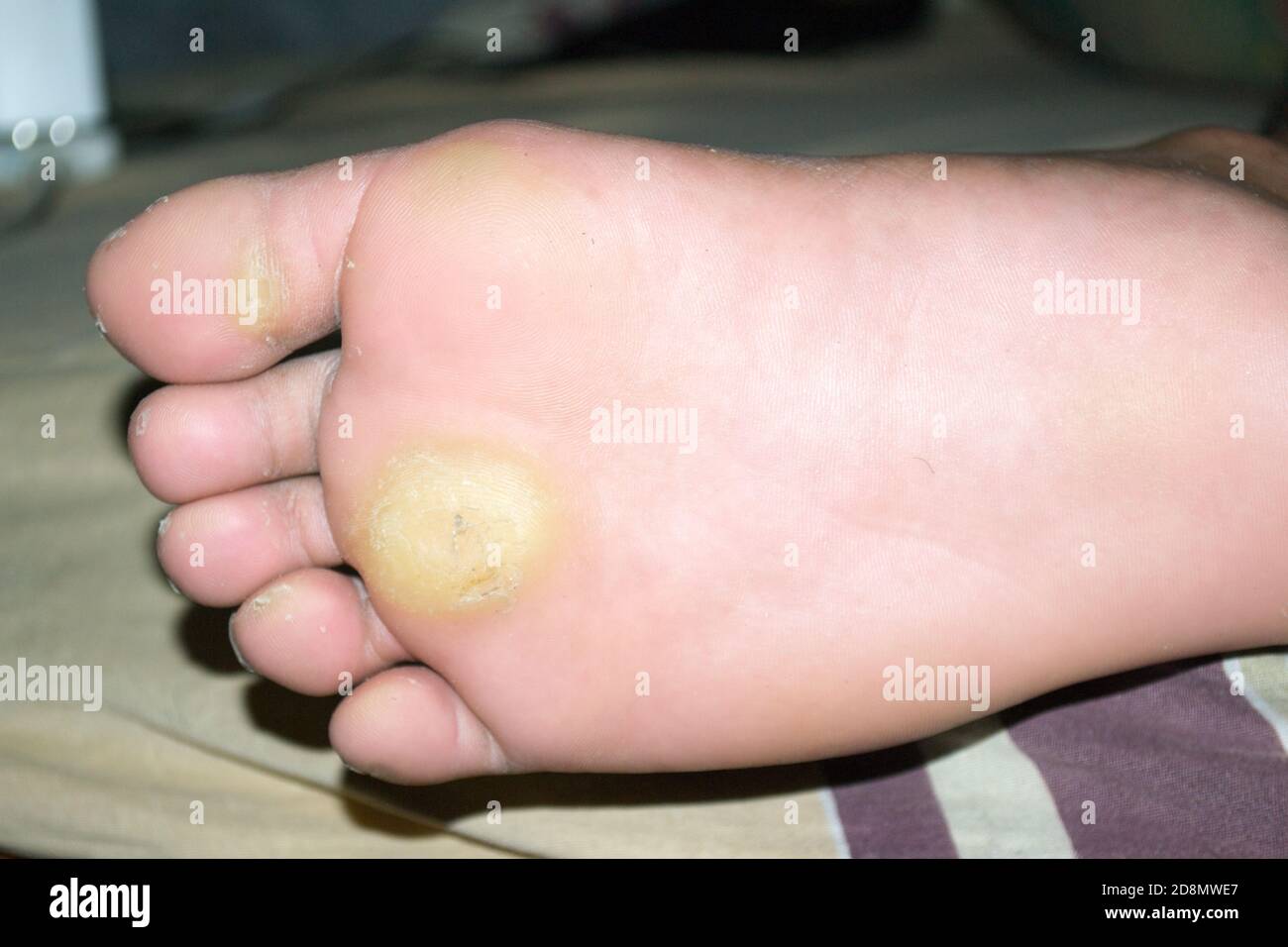 A callus is an area of thickened skin that forms as a response to ...