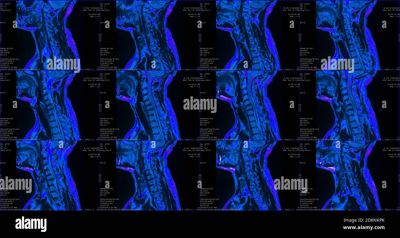 set of 12 sagittal blue colored MRI scans of neck area of caucasian 34 ...