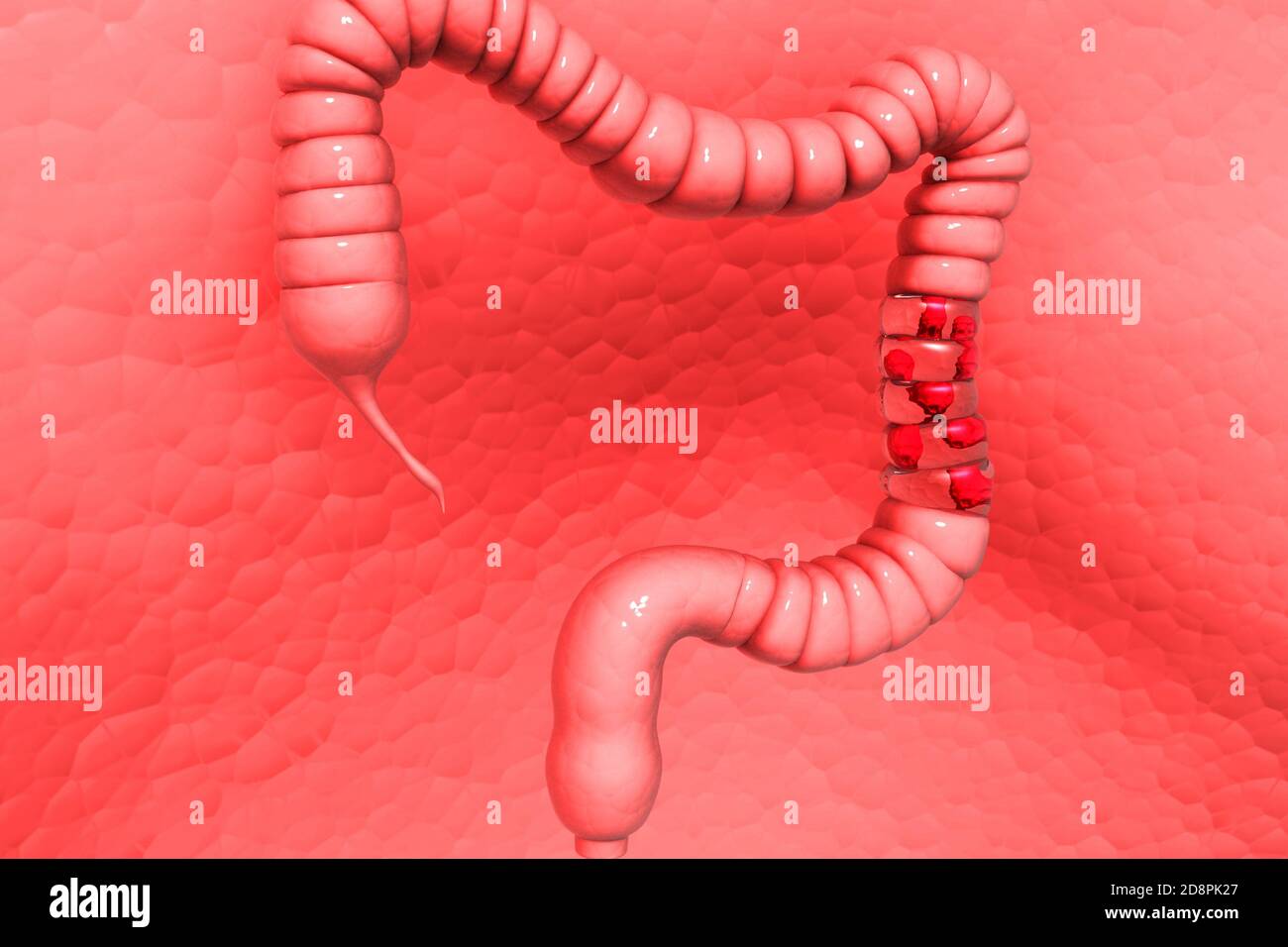 Intestines cancer hi-res stock photography and images - Alamy