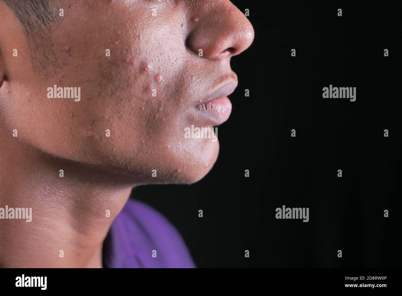Blemish face hi-res stock photography and images - Alamy