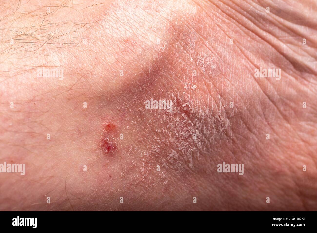 Close up dermatitis on the foot skin. Ill allergic peeling skin of ...